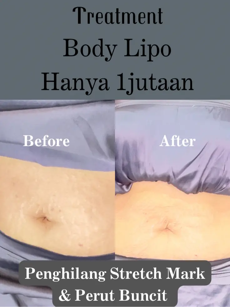 Body Lipo Penghilang Stretch Mark&Lemak Perut! | Video dipublikasikan oleh karishaizzati | Lemon8