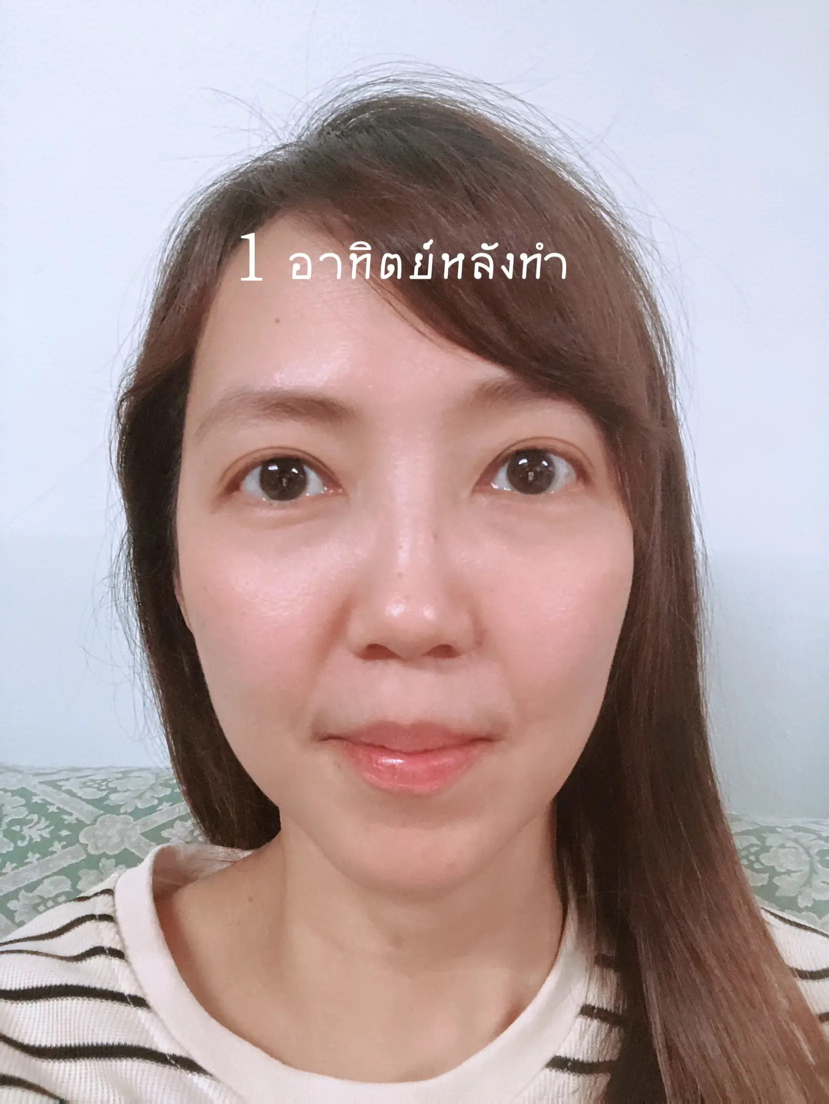 รีวิวลองทำ Hifu ครั้งแรกในชีวิต 😍 (my first time Hifu) | แกลเลอรีที่โพสต์โดย Phye Beautyhaus ...