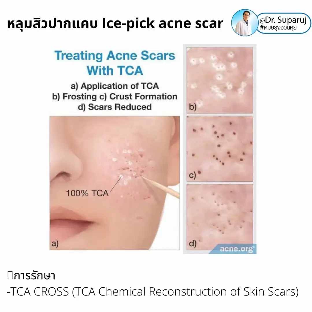 แต้มหลุมสิวด้วย TCA cross | แกลเลอรีที่โพสต์โดย ชิต้าร์ไปเรื่อย | Lemon8