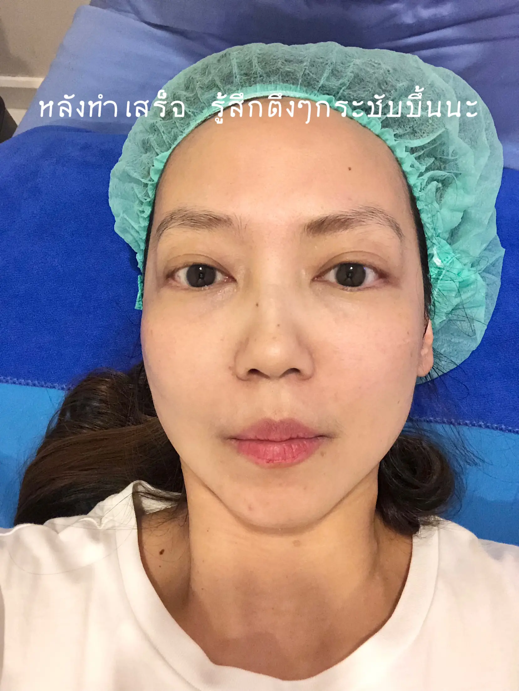 Talisa Clinic รีวิว Hifu - การค้นหาใน Lemon8
