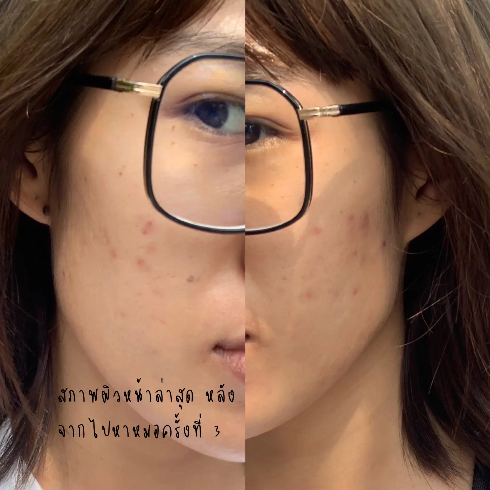 Review Acne Treatment with Dermatology Academy 🧑🏻‍⚕️🤩 Edition Comfort Money in Pocket | Gallery ...