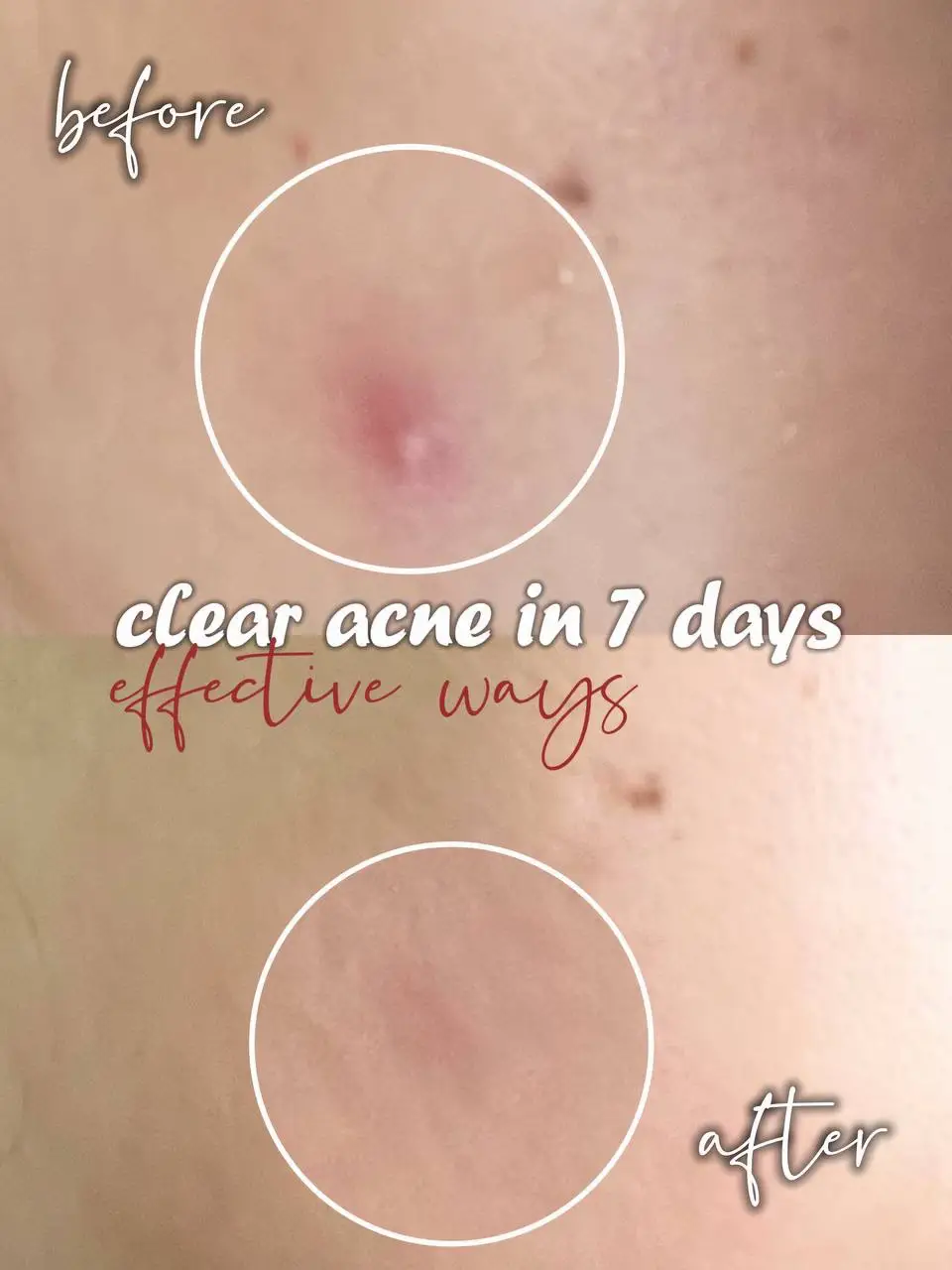 Clear Acne in 7 days | Honest Tips | Galeri disiarkan oleh syasya | Lemon8