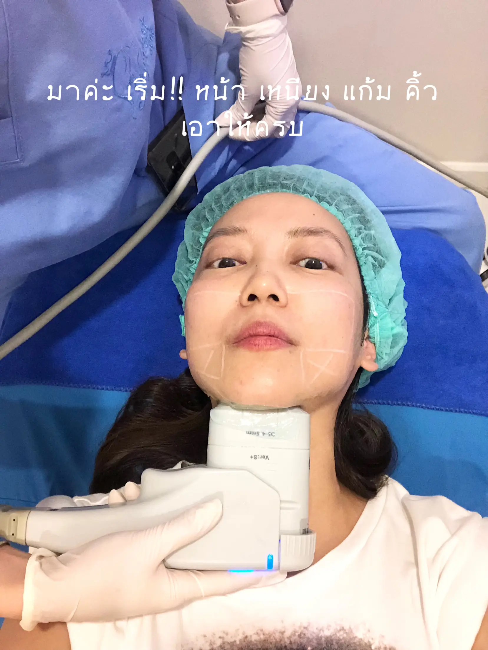 รีวิวลองทำ Hifu ครั้งแรกในชีวิต 😍 (my first time Hifu) | แกลเลอรีที่โพสต์โดย Phye Beautyhaus ...