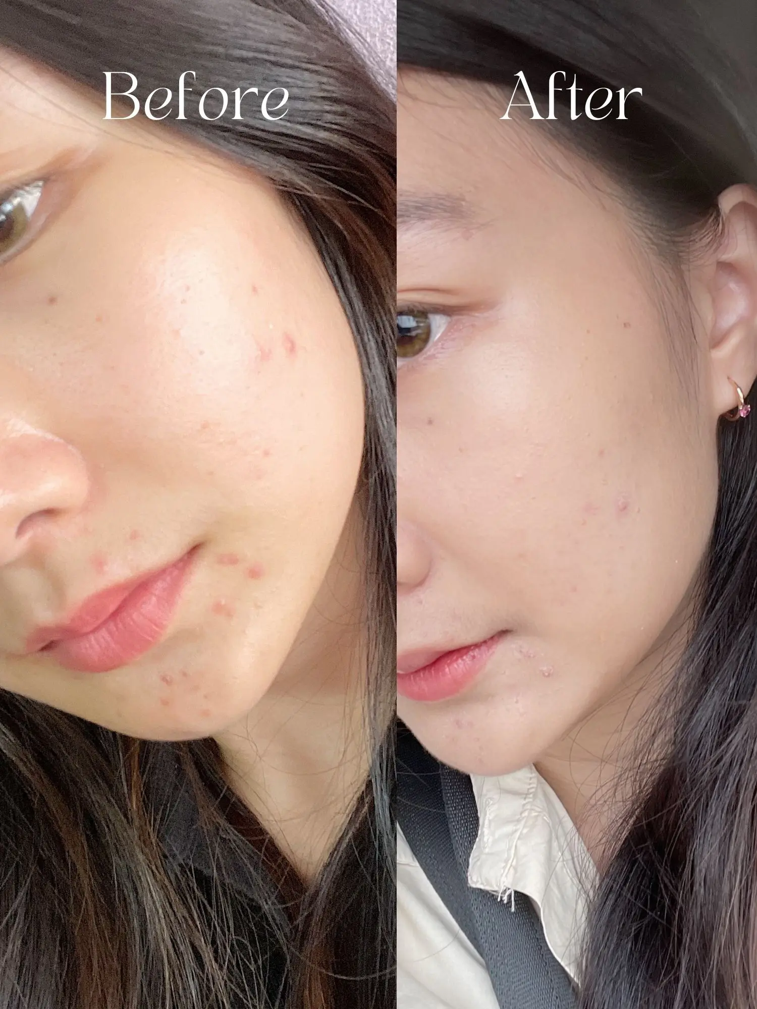 เมื่อคนเป็นสิวจำเป็นต้องแต่งหน้า l BK Acne BB | แกลเลอรีที่โพสต์โดย pear🍐 | Lemon8