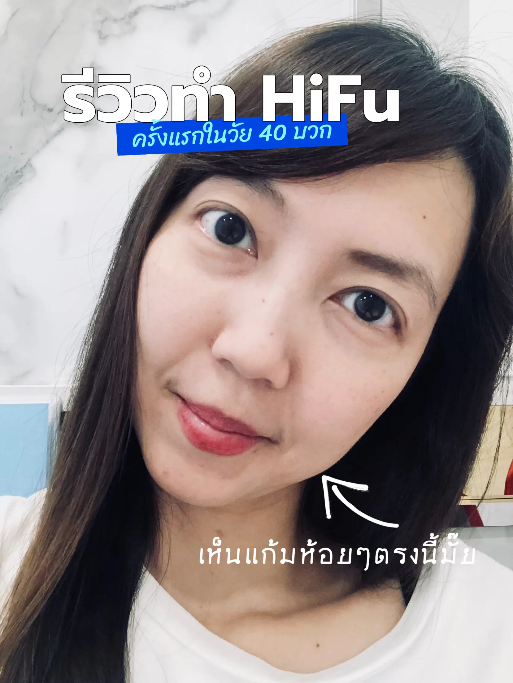 รีวิวลองทำ Hifu ครั้งแรกในชีวิต 😍 (my first time Hifu) | แกลเลอรีที่โพสต์โดย Phye Beautyhaus ...