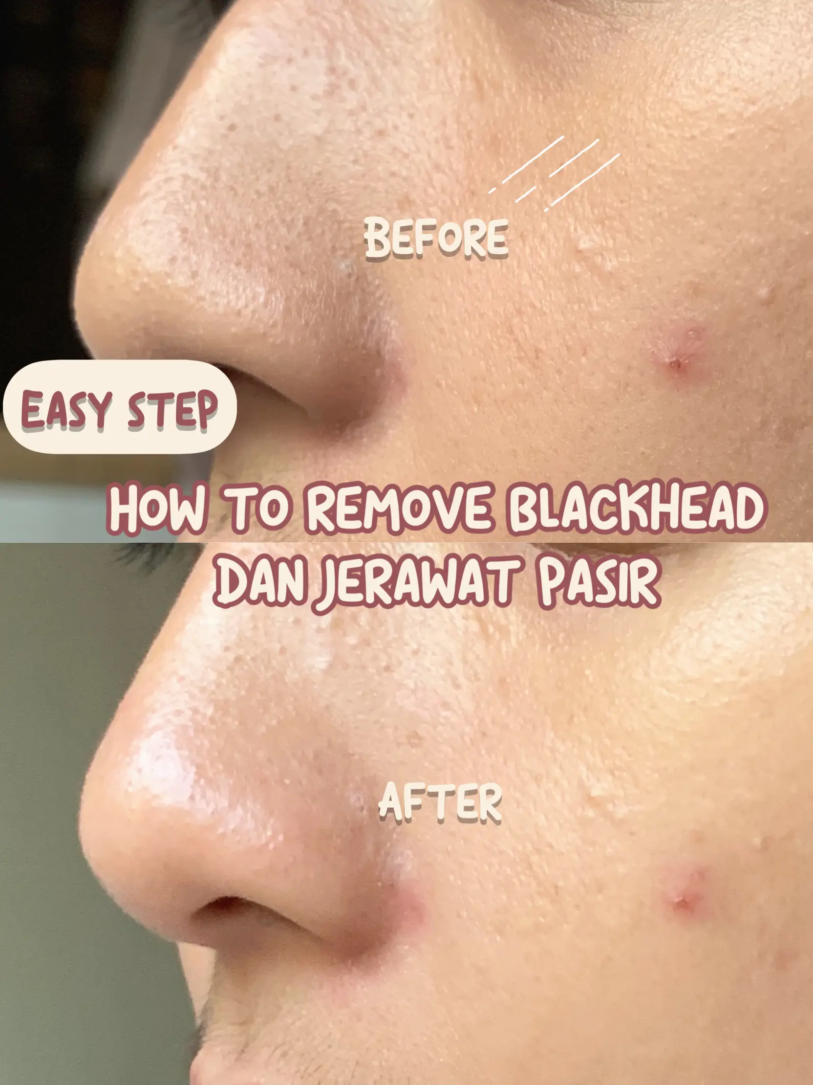 How to Remove Komedo dan Jerawat Pasir | Galeri diposting oleh Risa ...
