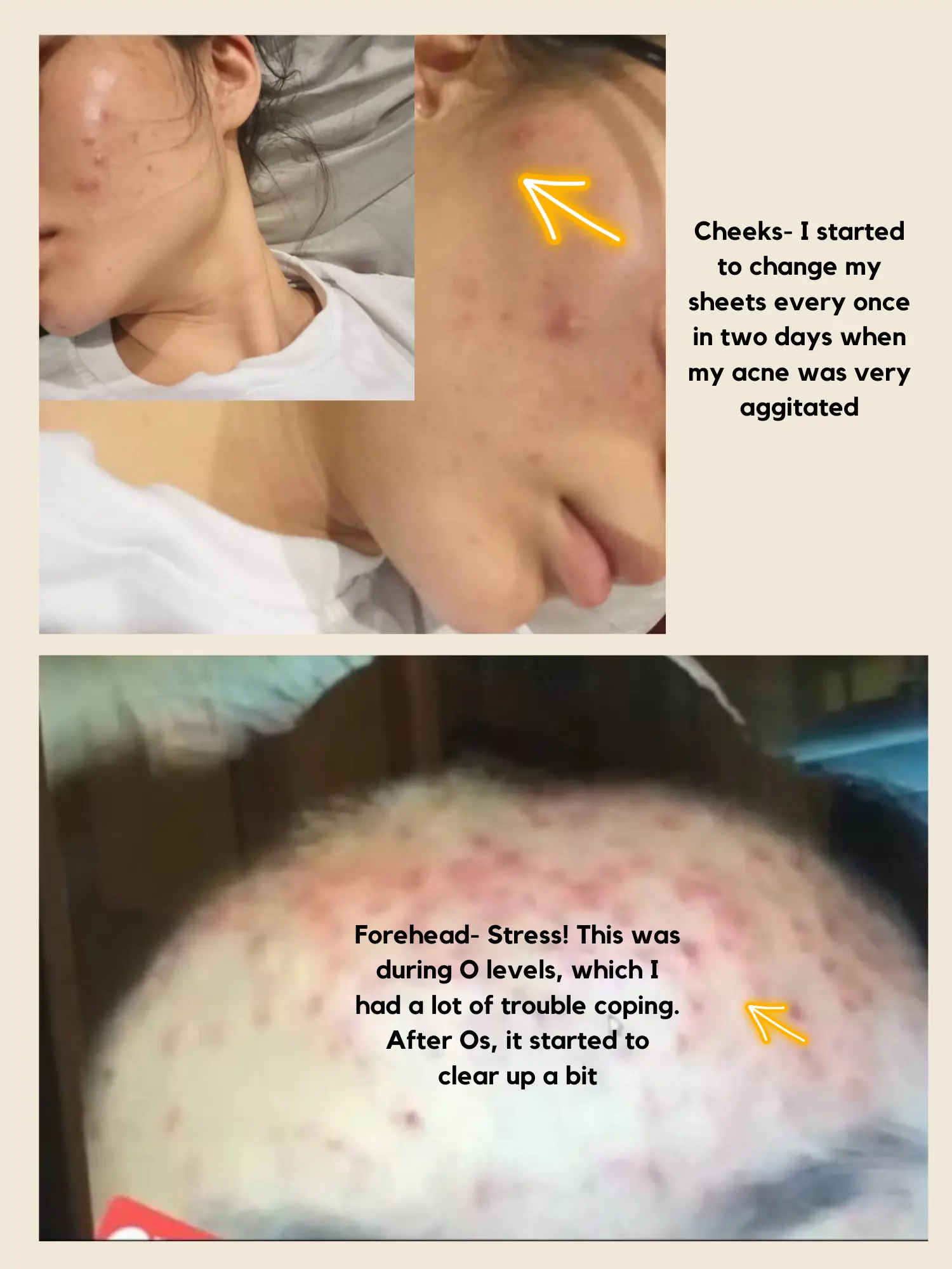 Finally cleared my skin 😮‍💨 My Acutane Experience | แกลเลอรีที่โพสต์โดย ...