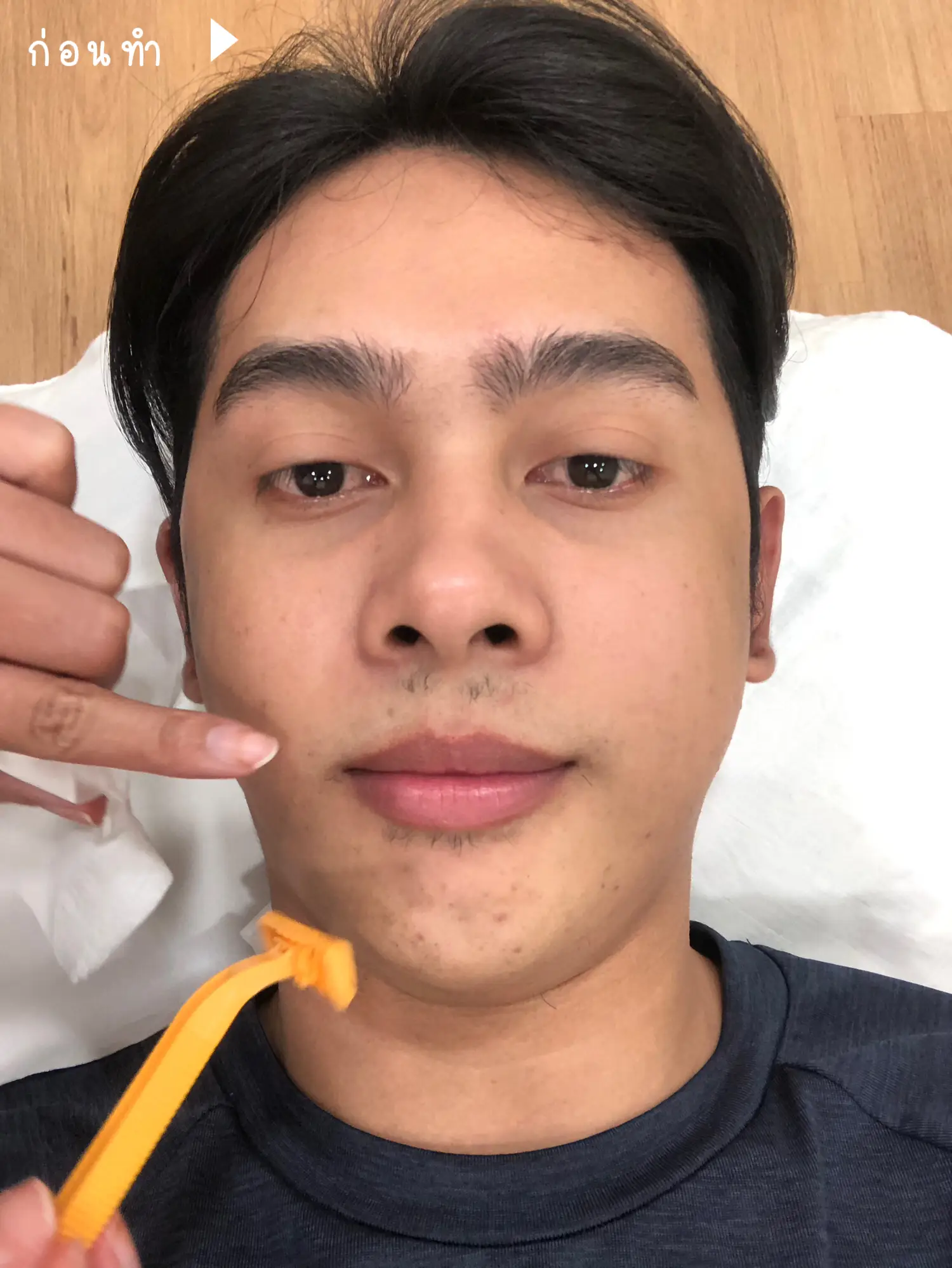 รีวิว เลเซอร์หนวดเครา ผู้ชาย🤴🏻ep.8 | แกลเลอรีที่โพสต์โดย Mchakorn | Lemon8