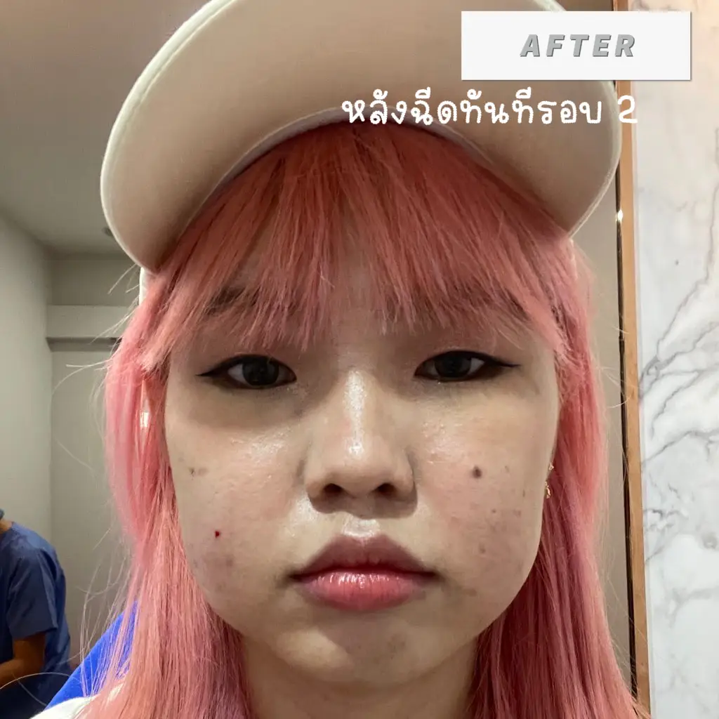 Talisa Clinic รีวิว Hifu การค้นหาใน Lemon8