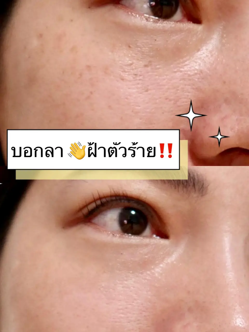 บอกลา👋 ฝ้าตัวร้าย‼️ จุดดำ ฝ้า จางลงใน 2 week 😍 | แกลเลอรีที่โพสต์โดย Primpaphat.ae | Lemon8