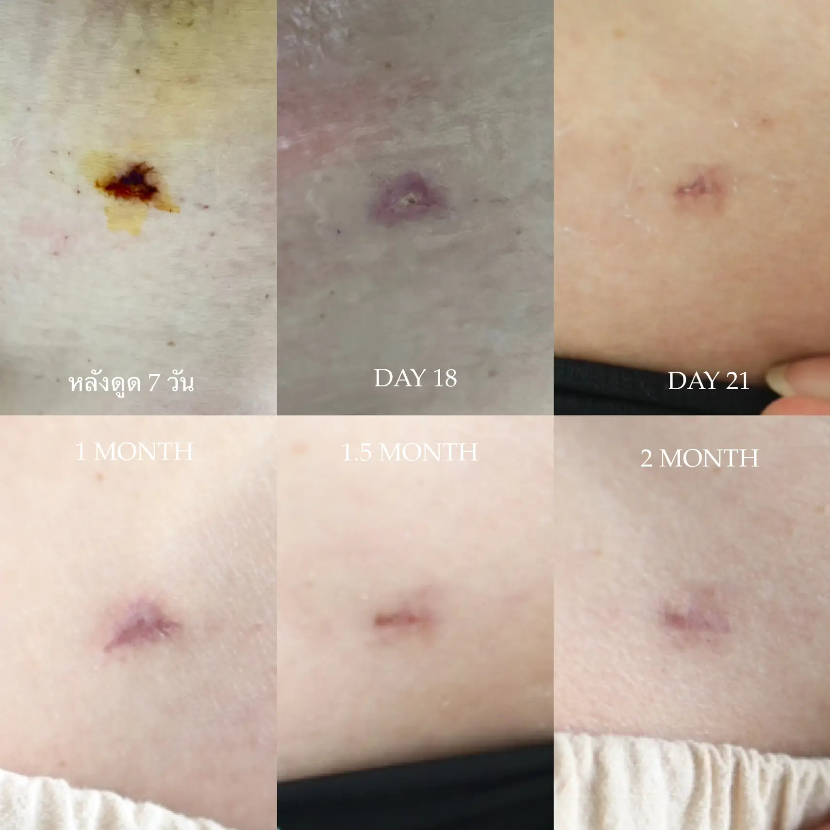 สยบรอยแผลดูดไขมันด้วย Dagoderma Scar Emulgel | แกลเลอรีที่โพสต์โดย May ...