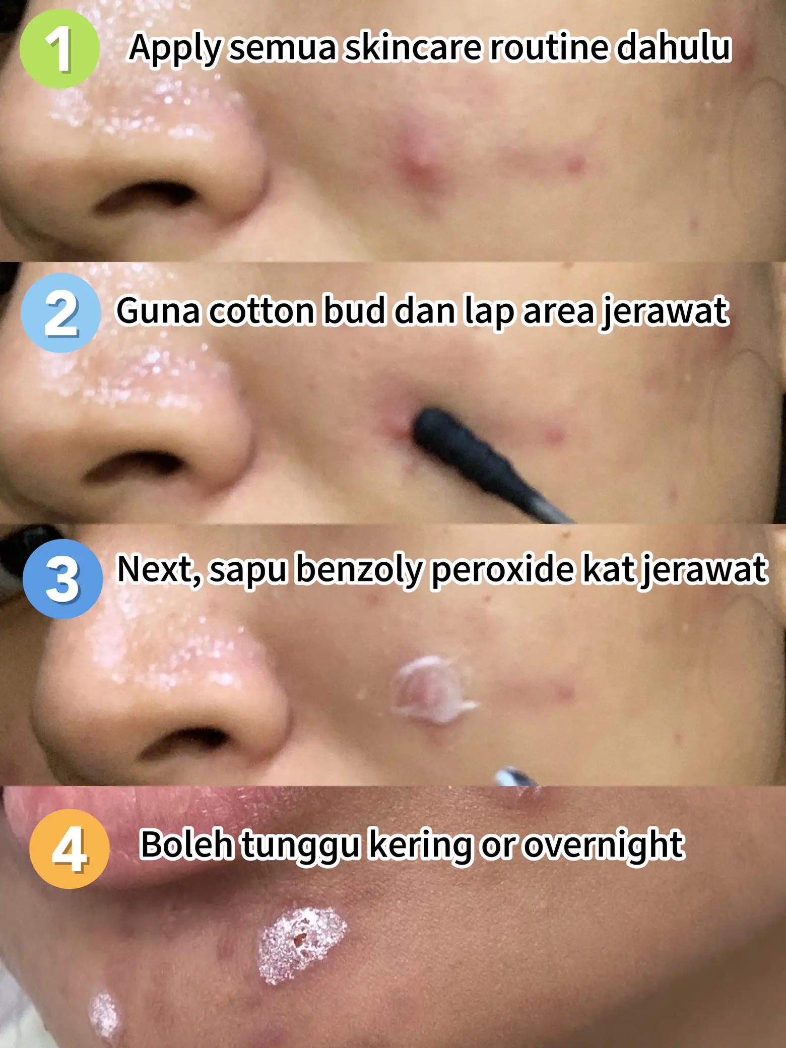 Cara cara nak pakai Benzoly Peroxide | Galeri disiarkan oleh Fara ...