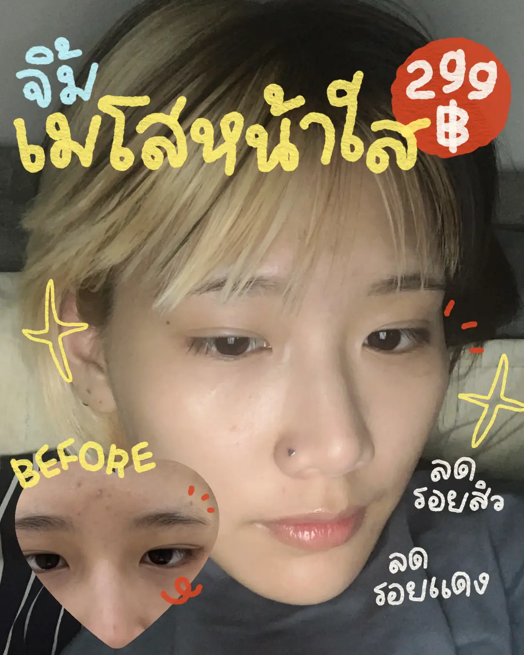 💉 รีวิวเมโสหน้าใส 299B 𓂃 สามวันรอยสิวจาง 🫧 | แกลเลอรีที่โพสต์โดย วิฬาร์ /ᐠ •⩊•マ | Lemon8