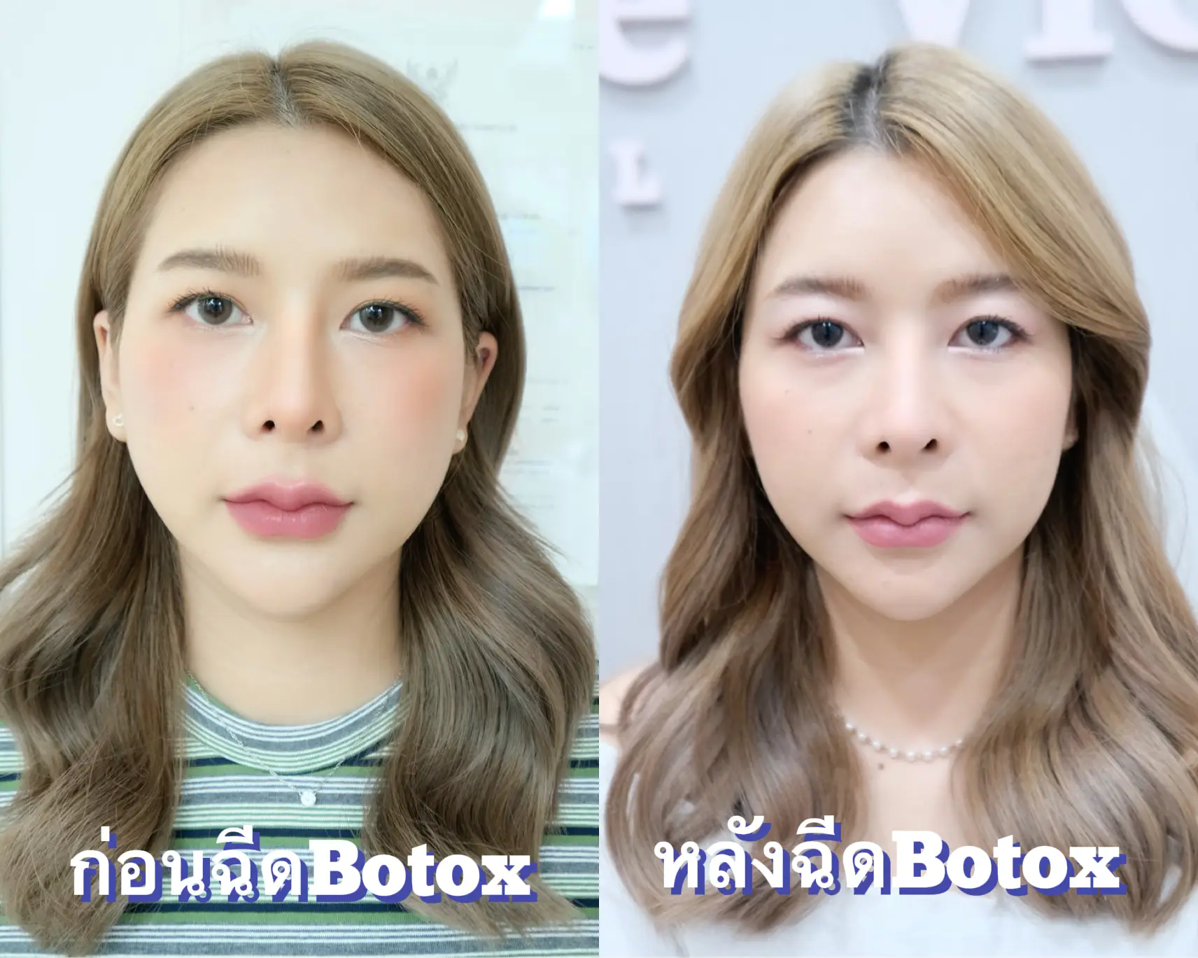 มารีวิวการฉีดBotox หน้าเล็กเรียวขึ้นจริงๆ | แกลเลอรีที่โพสต์โดย B’bow | Lemon8