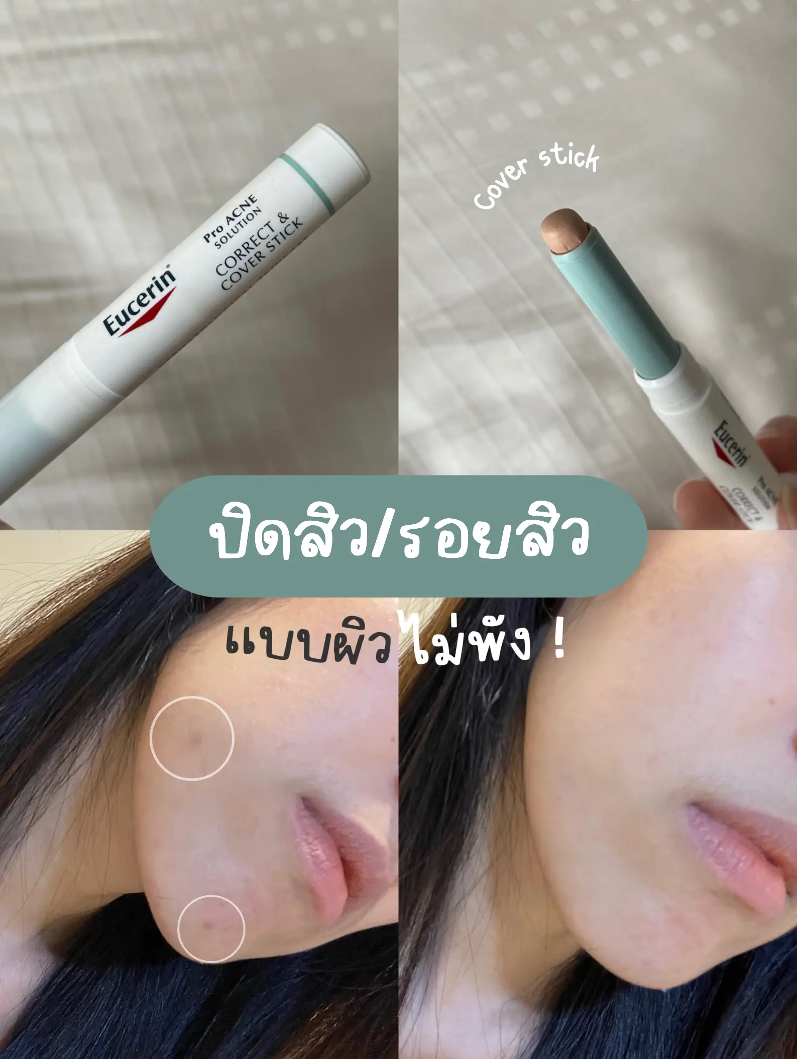 ปิดสิว รอยสิว แบบผิวไม่พังเพิ่ม! | แกลเลอรีที่โพสต์โดย Mildmalaii | Lemon8