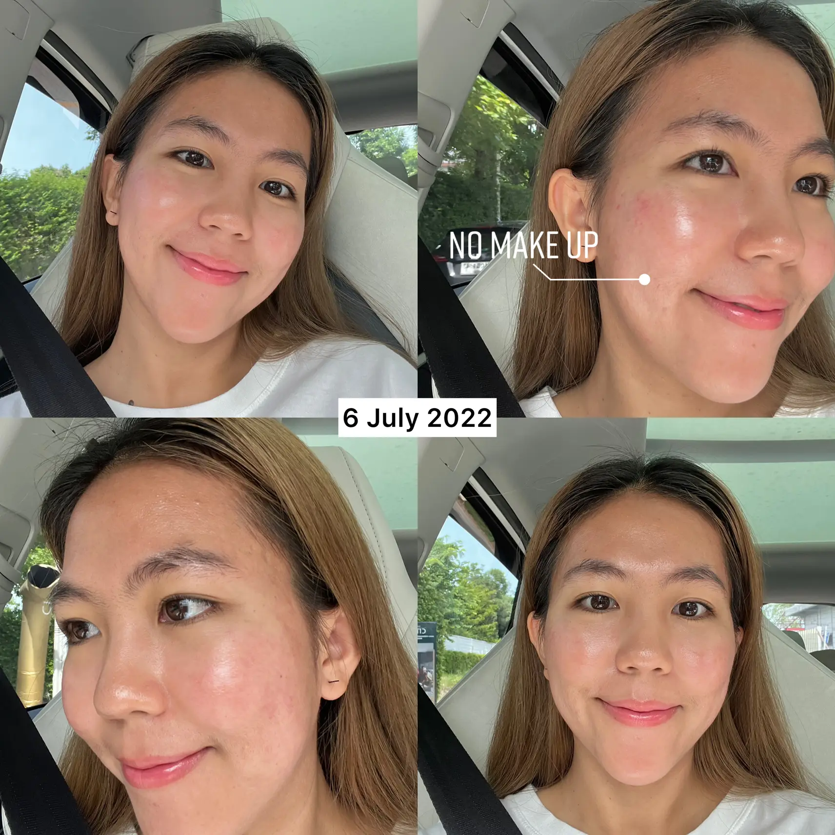 รีวิว Pico Laser+ Meso fat ที่ Dii | แกลเลอรีที่โพสต์โดย Fernnydiaryy ...