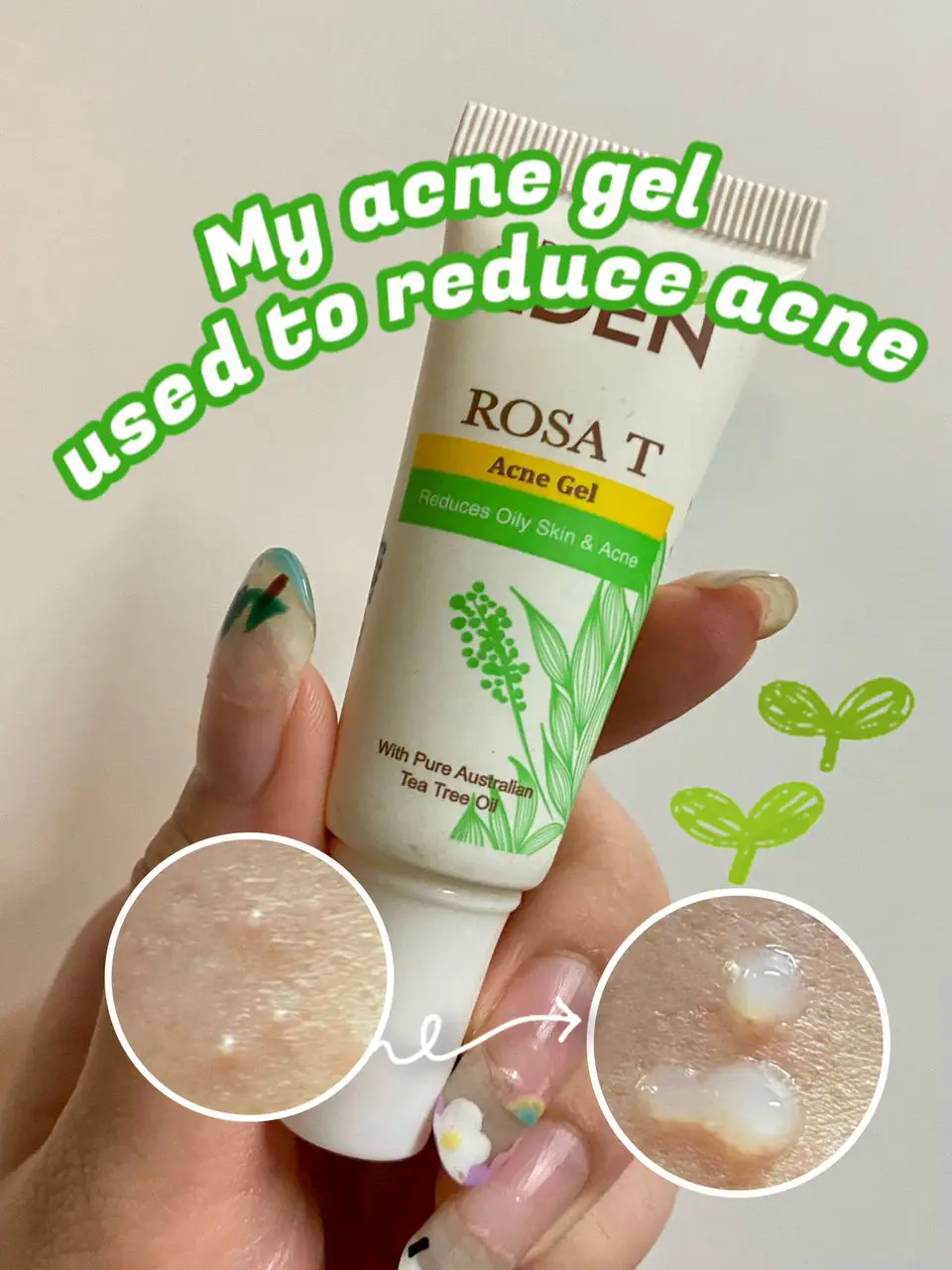 My acne gel to reduce acne | Galeri disiarkan oleh Faye 🐨 | Lemon8