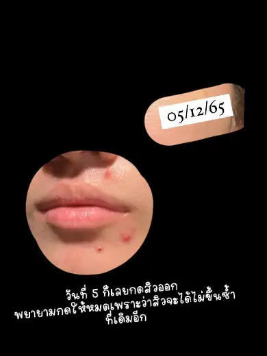 รักษาสิวใน 5 วัน (ฉบับสิวไม่เยอะ) 🌟 | แกลเลอรีที่โพสต์โดย mp | Lemon8