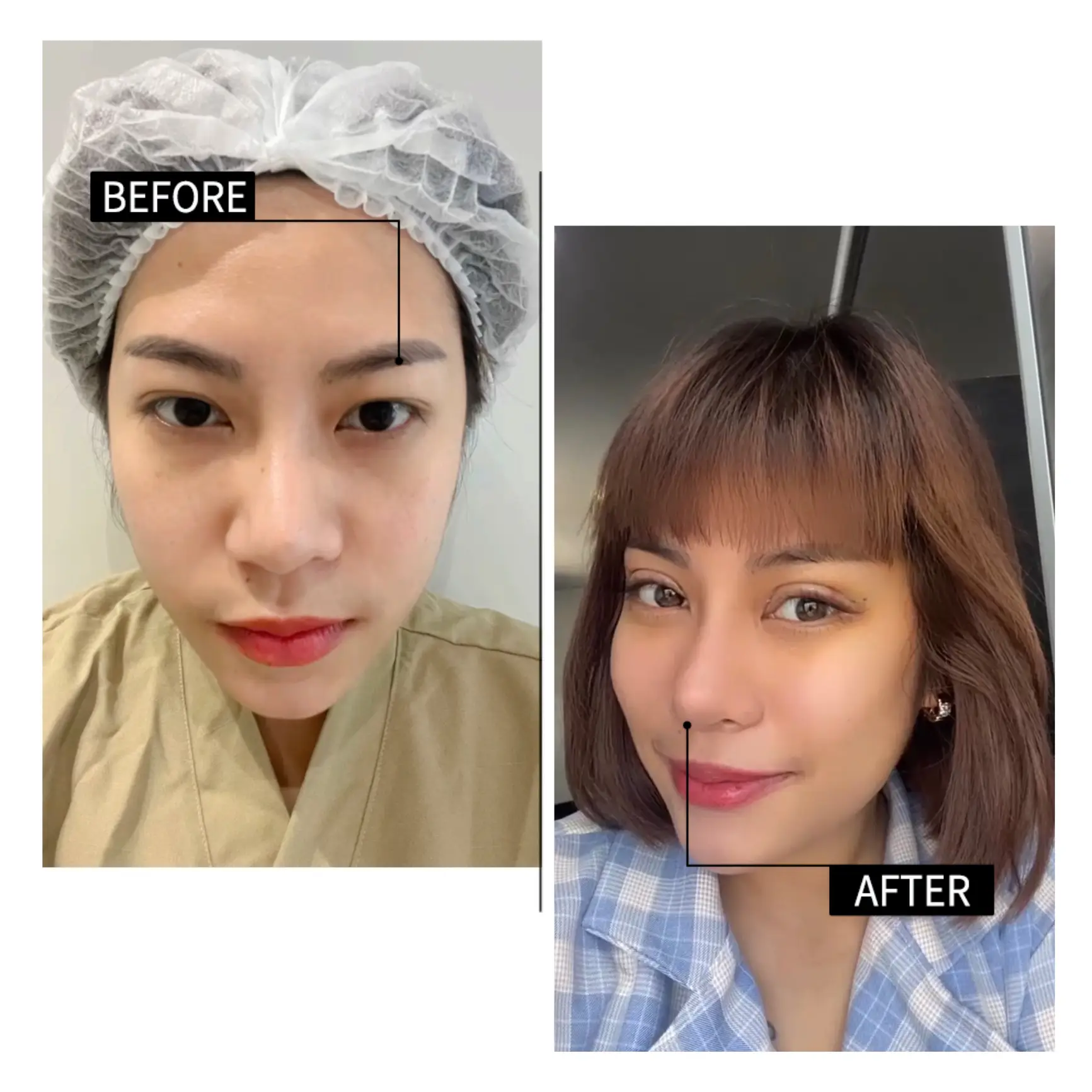 ศัลยกรรมตา 2 ชั้น | แกลเลอรีที่โพสต์โดย Pookky Byp | Lemon8