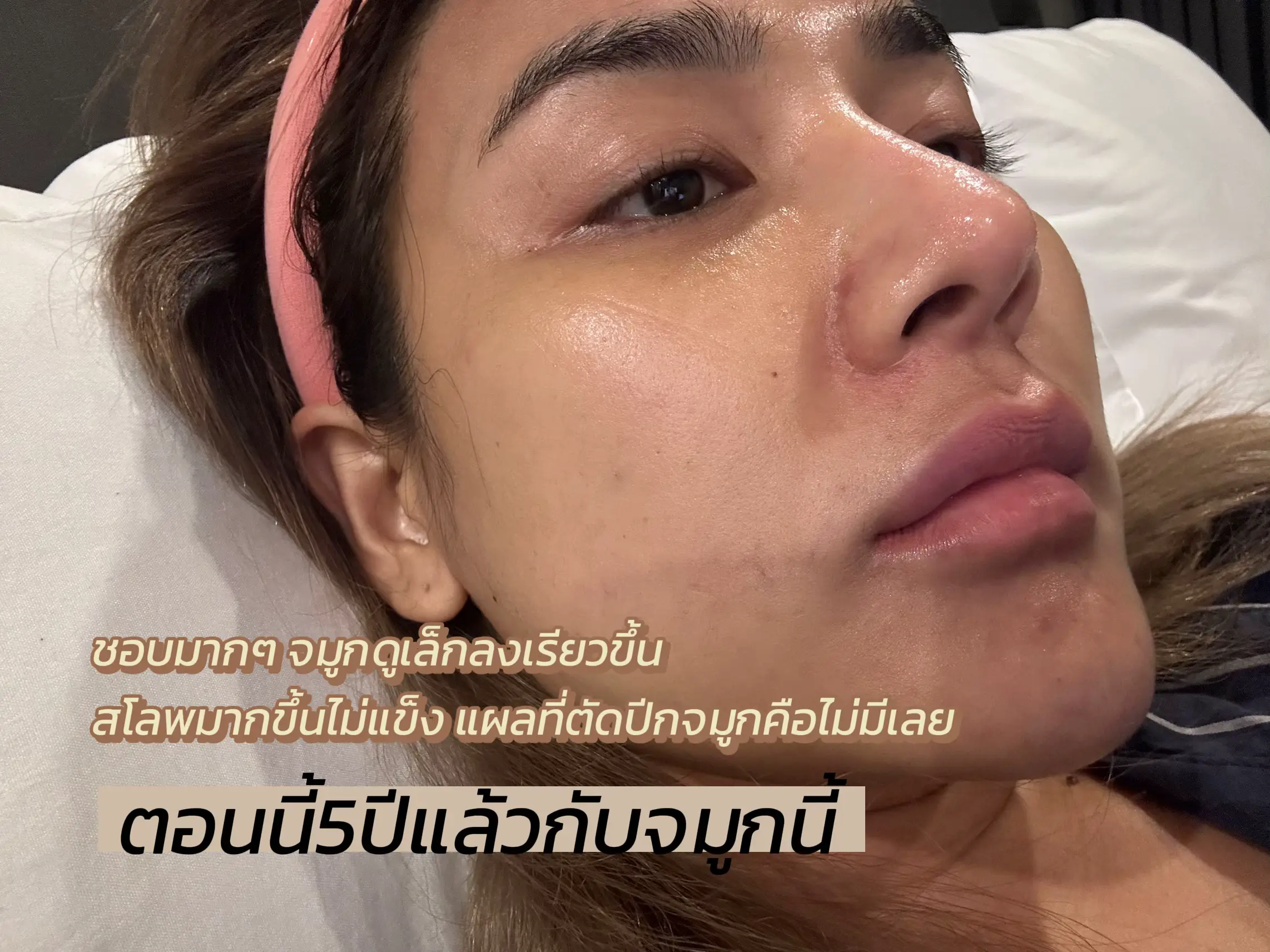 แก้จมูกรอบ2ปังหรือตุบมาดูกัน | แกลเลอรีที่โพสต์โดย Napatch.kat | Lemon8