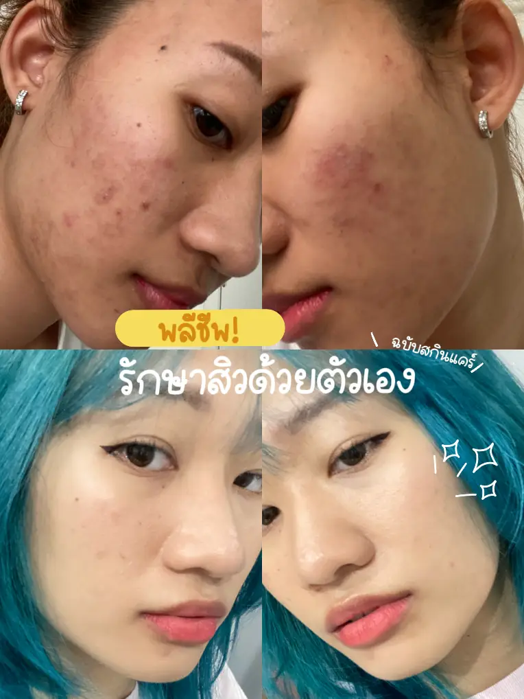 Ep.1 กู้สิวเห่อ ภายใน7วัน! (No Spon) | แกลเลอรีที่โพสต์โดย ffernfk | Lemon8