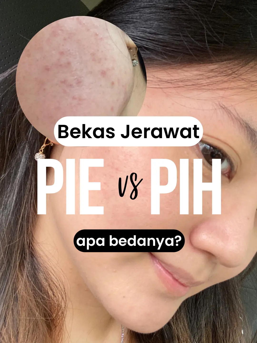 Bekas Jerawat: PIE vs PIH? Apa bedanya?🤔 | Galeri diposting oleh ...