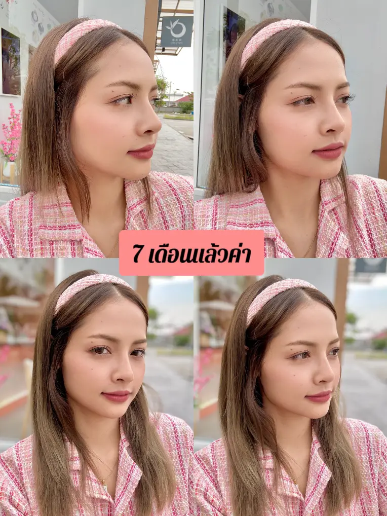 รีวิวศัลยกรรมเสริมจมูกครั้งแรก EMMA Clinic | แกลเลอรีที่โพสต์โดย Mint Chali | Lemon8