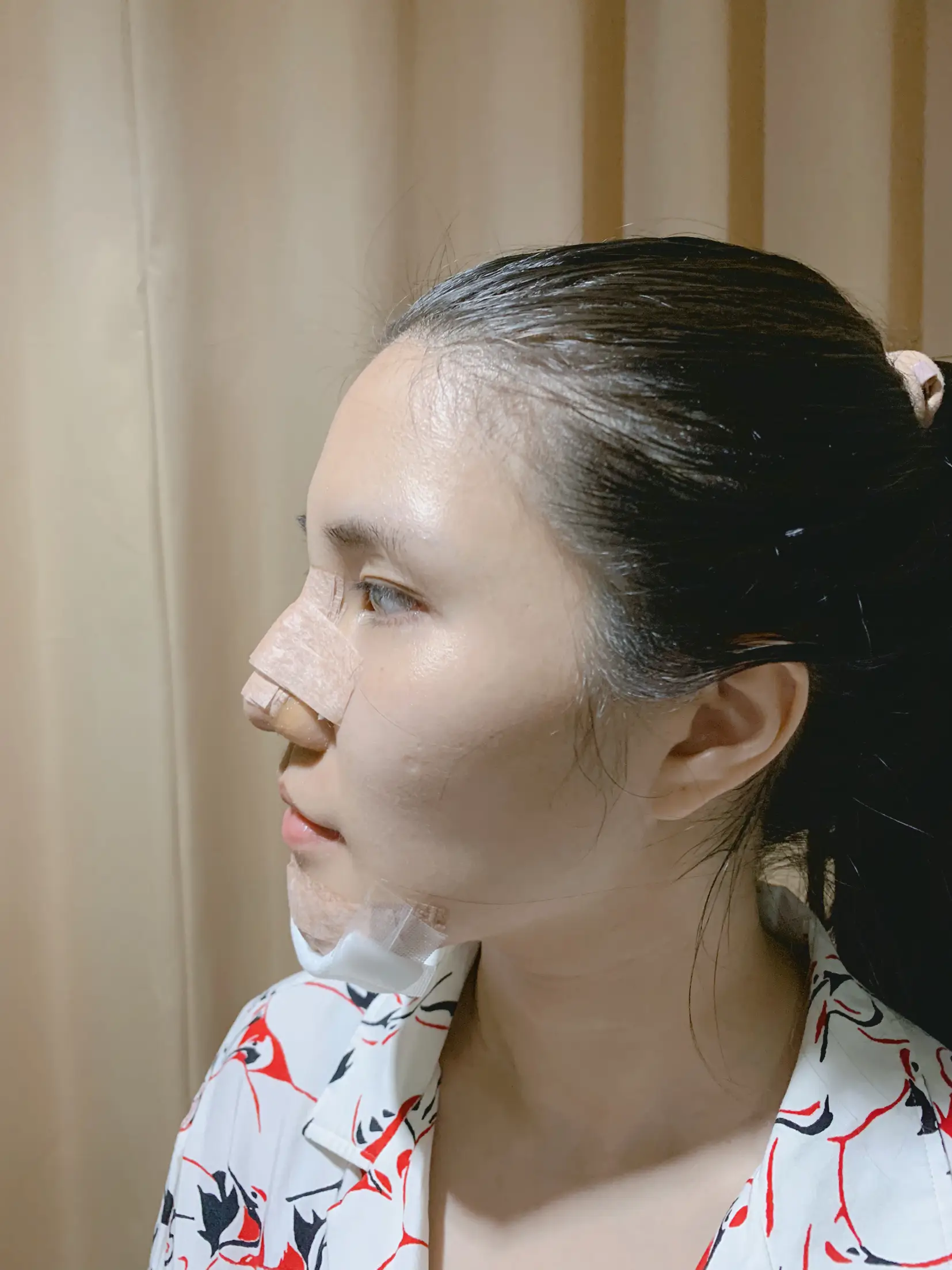 ดูแลตัวเองหลังศัลยกรรม ทำยังไงไม่ให้บวมเยอะ !!! | แกลเลอรีที่โพสต์โดย Ploycobra | Lemon8