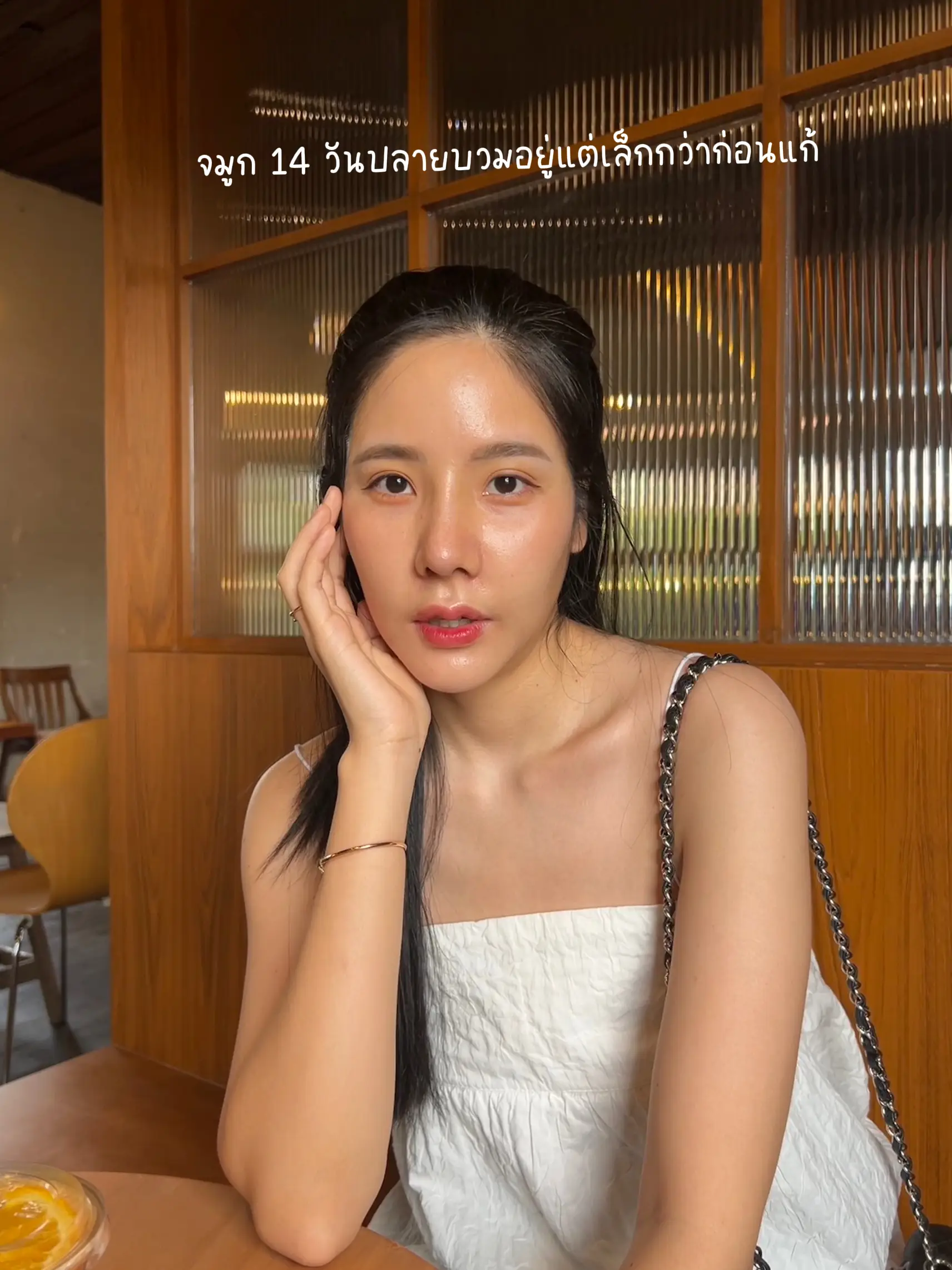 รีวิวประสบการณ์แก้จมูกกับคุณหมอไทย 380,000 บาท | แกลเลอรีที่โพสต์โดย ...