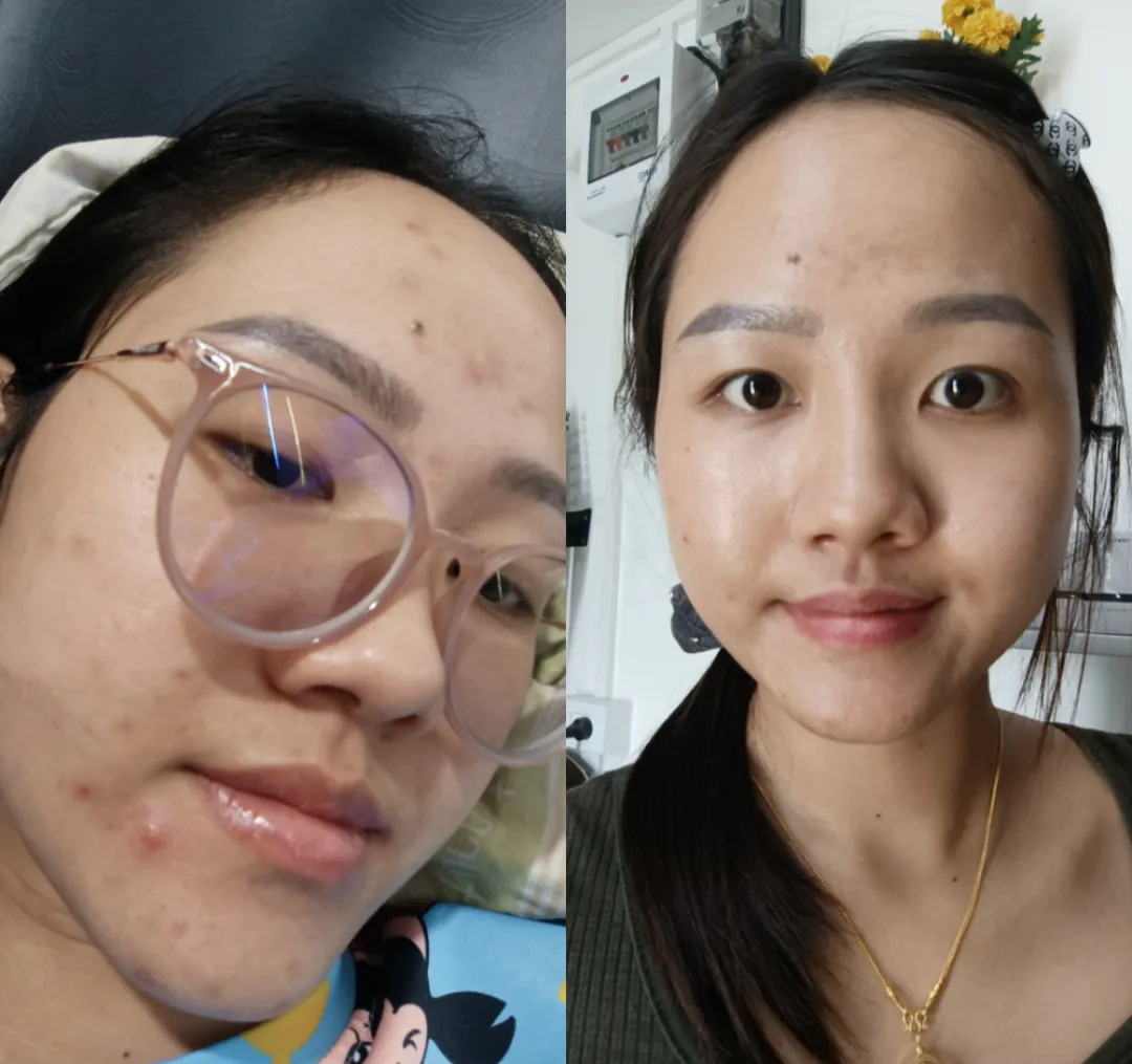 ใช้ BHA ยังไงไม่ให้หน้าพัง | แกลเลอรีที่โพสต์โดย Oumbun.Skin | Lemon8