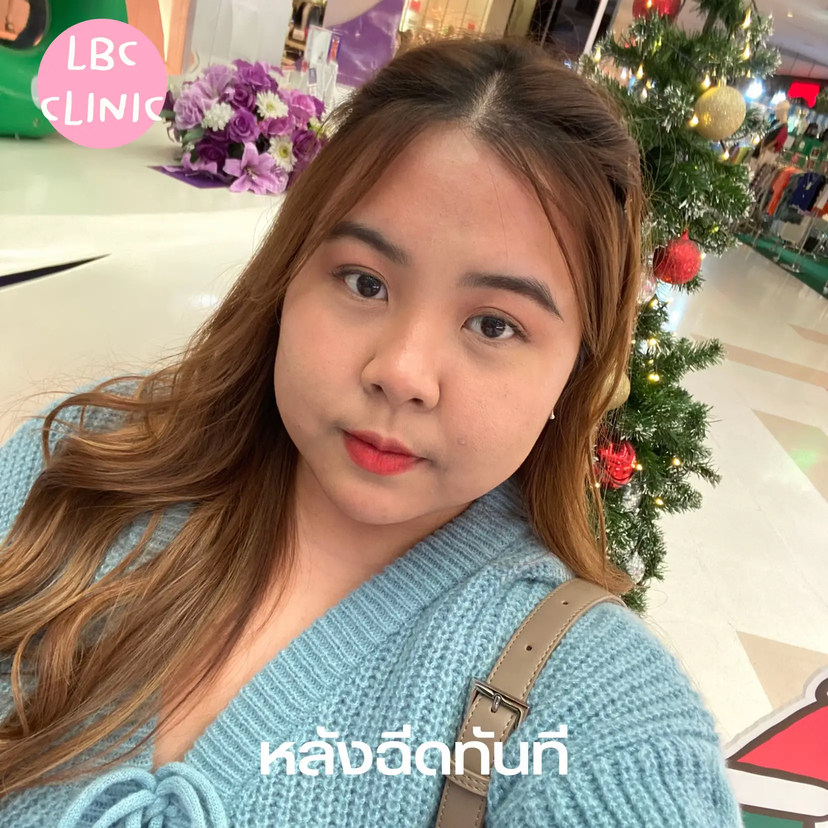 ฉีดแฟตหน้า เหนียง lbc - การค้นหาใน Lemon8