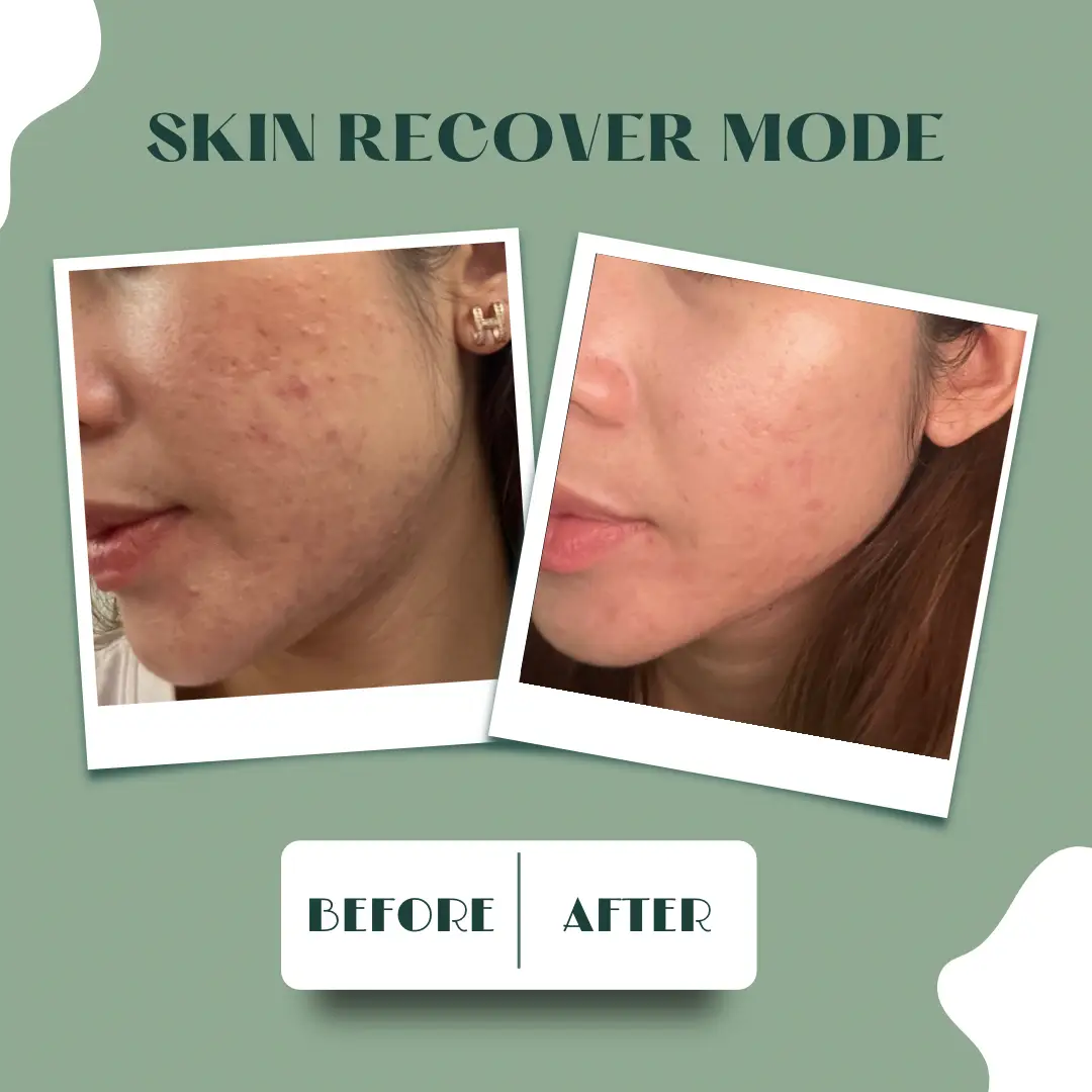 7 Days Recover skin กู้ผิวกัน 🥰 | แกลเลอรีที่โพสต์โดย pangawika | Lemon8