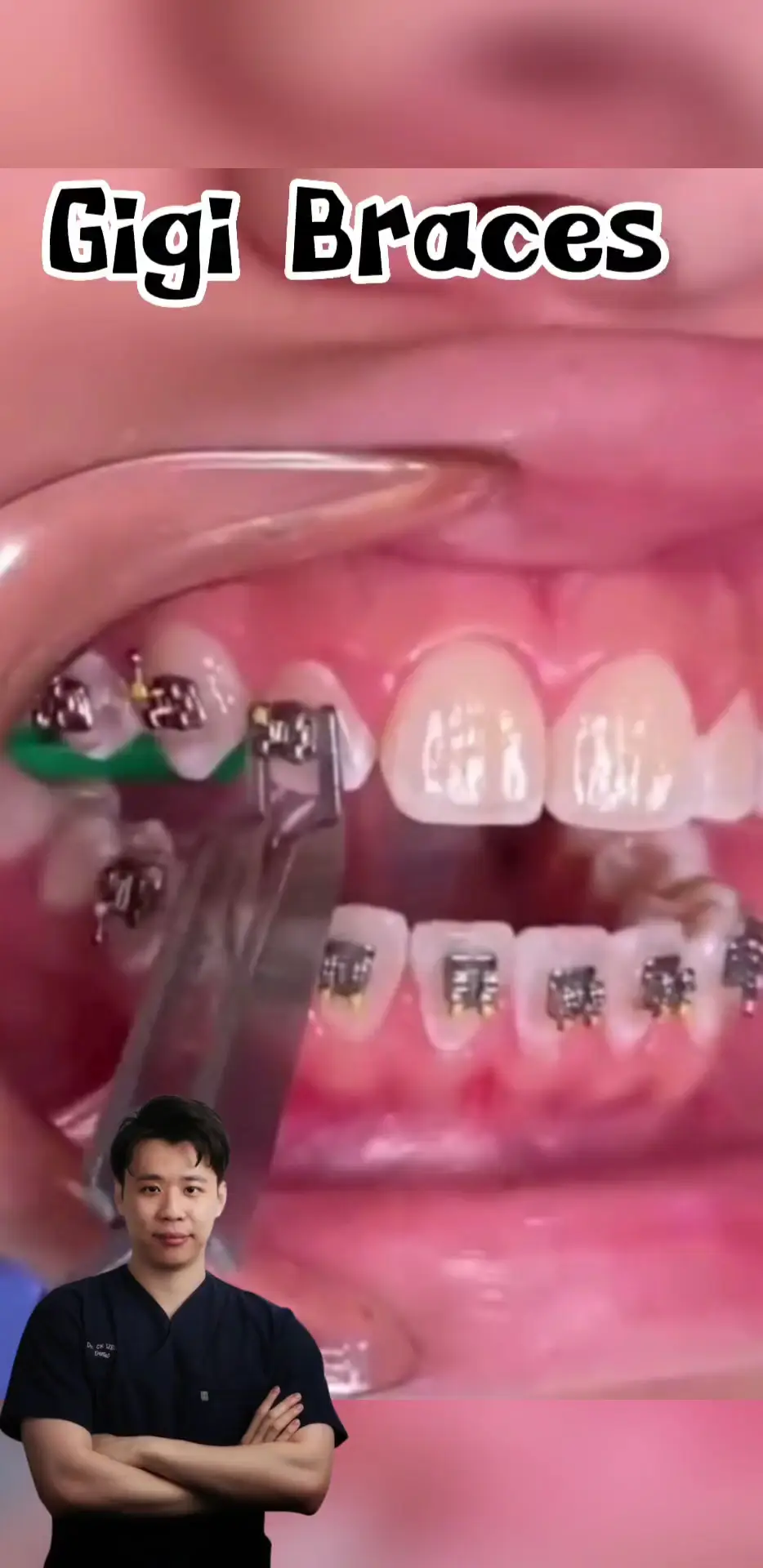 Apakah Orthodontic Braces (Pendakap Gigi)? | Video diterbitkan oleh Dr ...