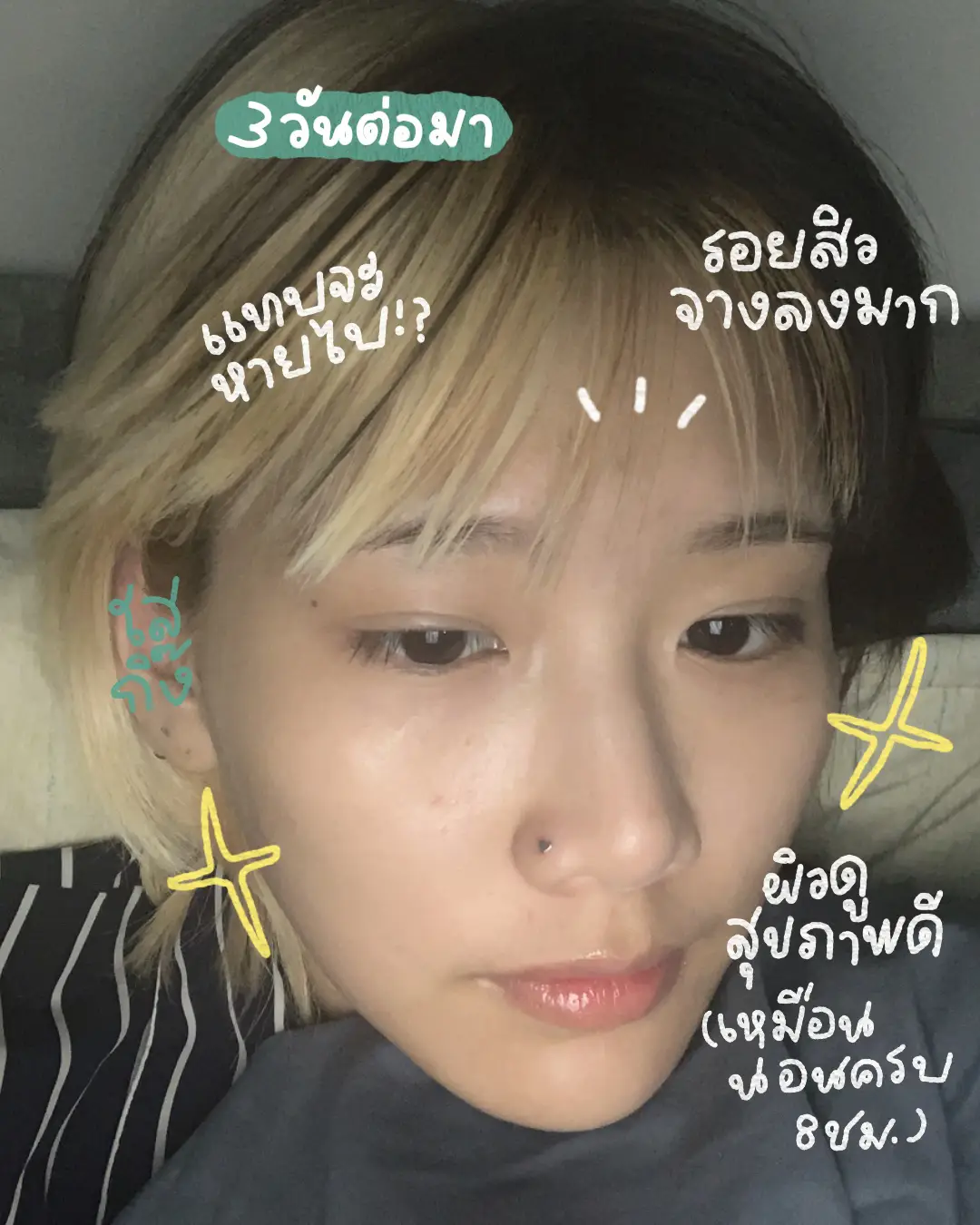 💉 รีวิวเมโสหน้าใส 299B 𓂃 สามวันรอยสิวจาง 🫧 | แกลเลอรีที่โพสต์โดย วิฬาร์ /ᐠ •⩊•マ | Lemon8