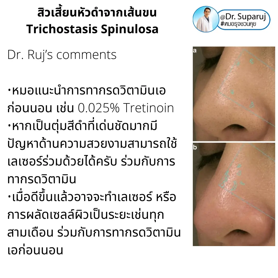 Black-headed splinter wide pore from Trichostasis spinulosa hair line ...