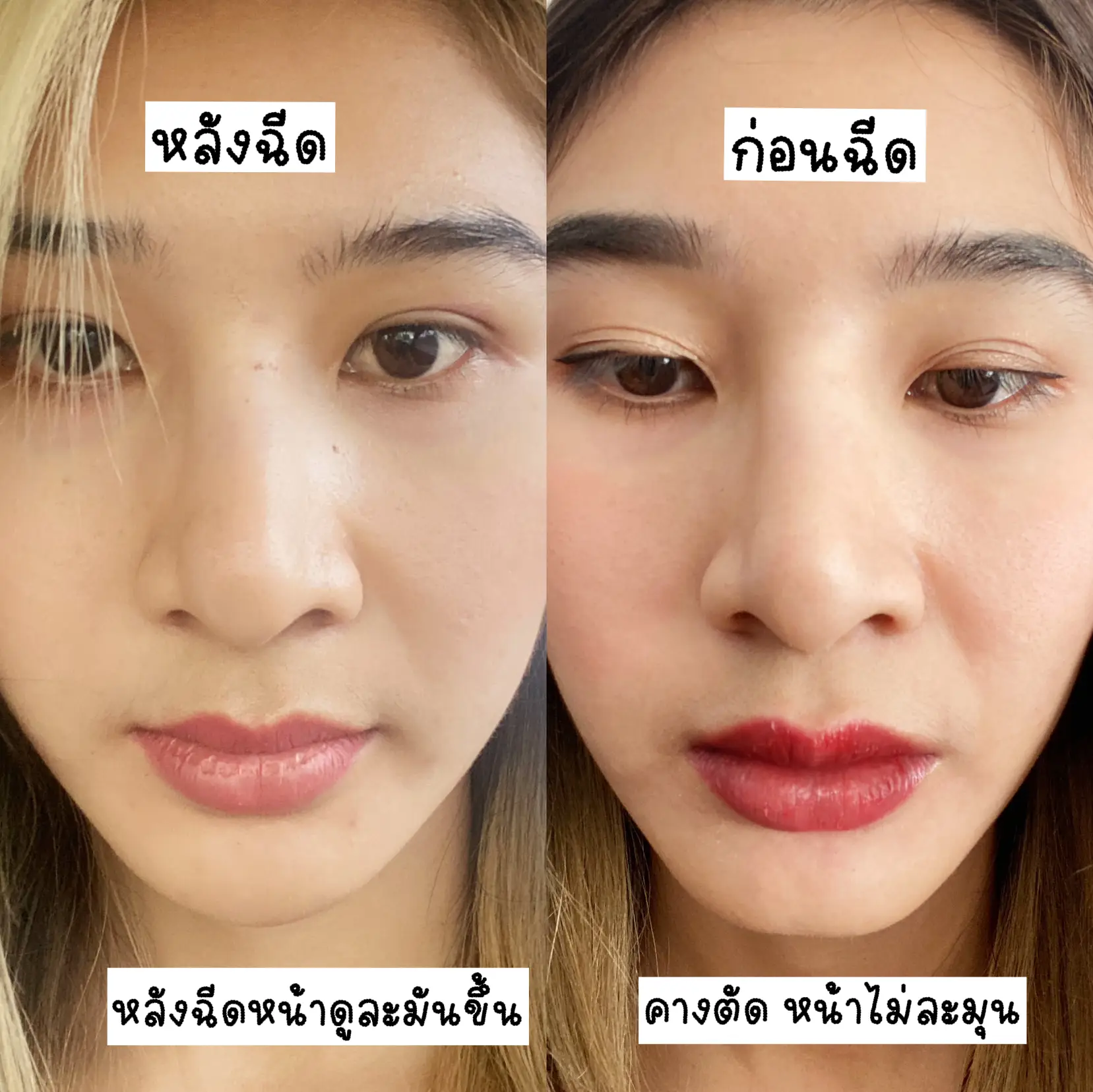 Filler คางกี่ cc - การค้นหาใน Lemon8