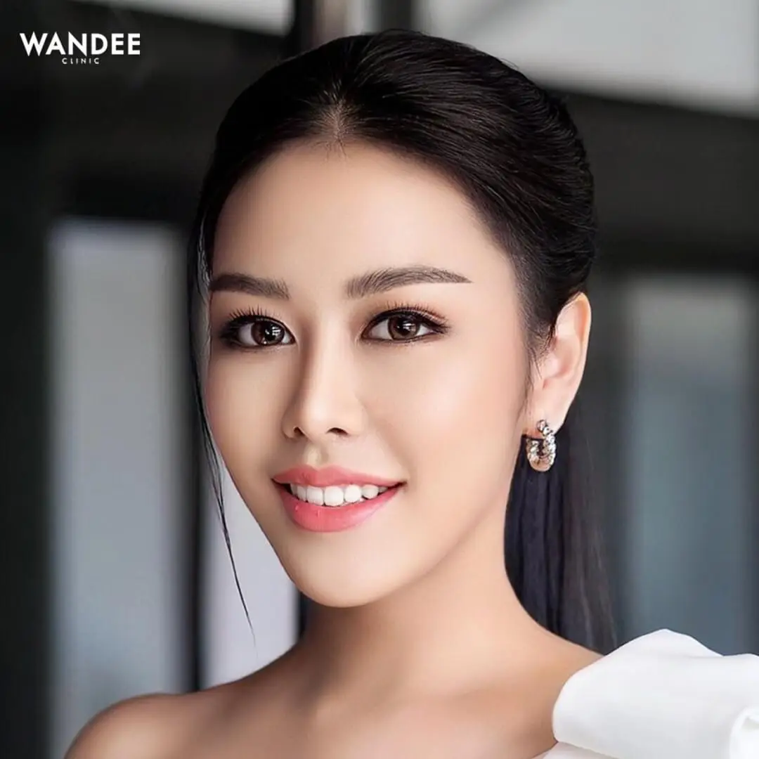 Review : เปลี่ยนคางตัด ให้เป็นคางเรียวสวย🤩 | แกลเลอรีที่โพสต์โดย Wandee Clinic | Lemon8