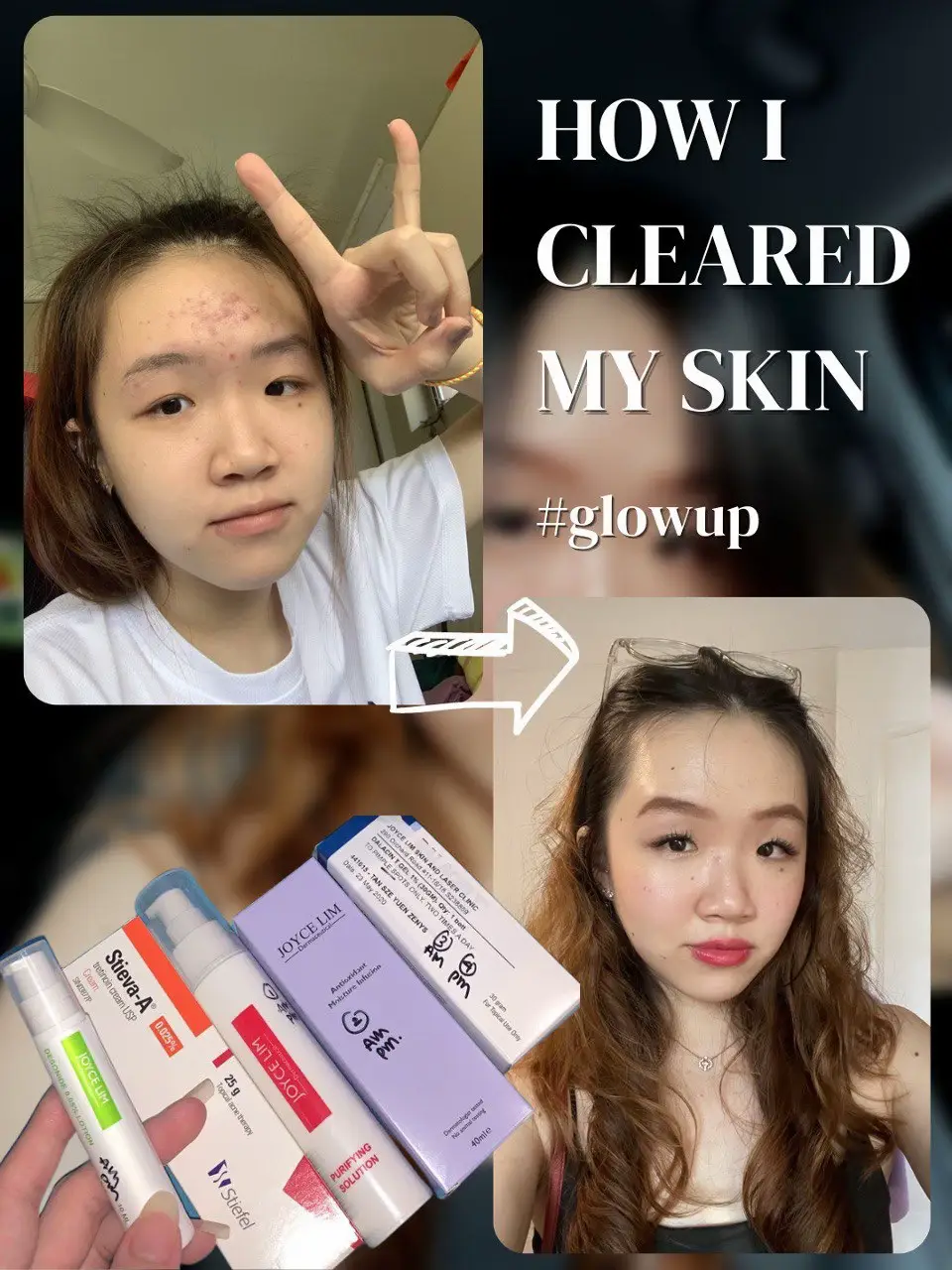 how i cleared my skin 🧴 | Gallery posted by zenys | Lemon8