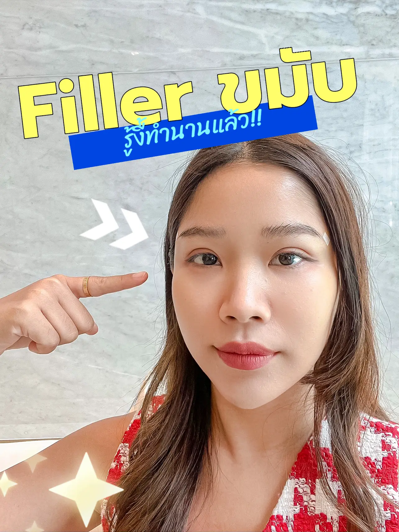 Temporary filler injection review | Gallery posted by Sinderstory | Lemon8