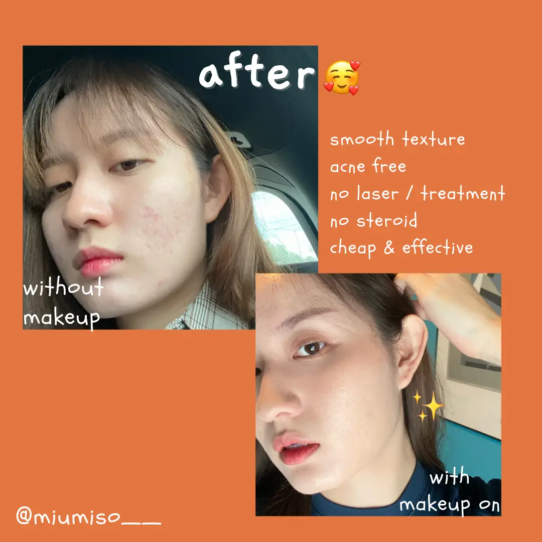 Tretinoin and Hyperpigmentation - การค้นหาใน Lemon8