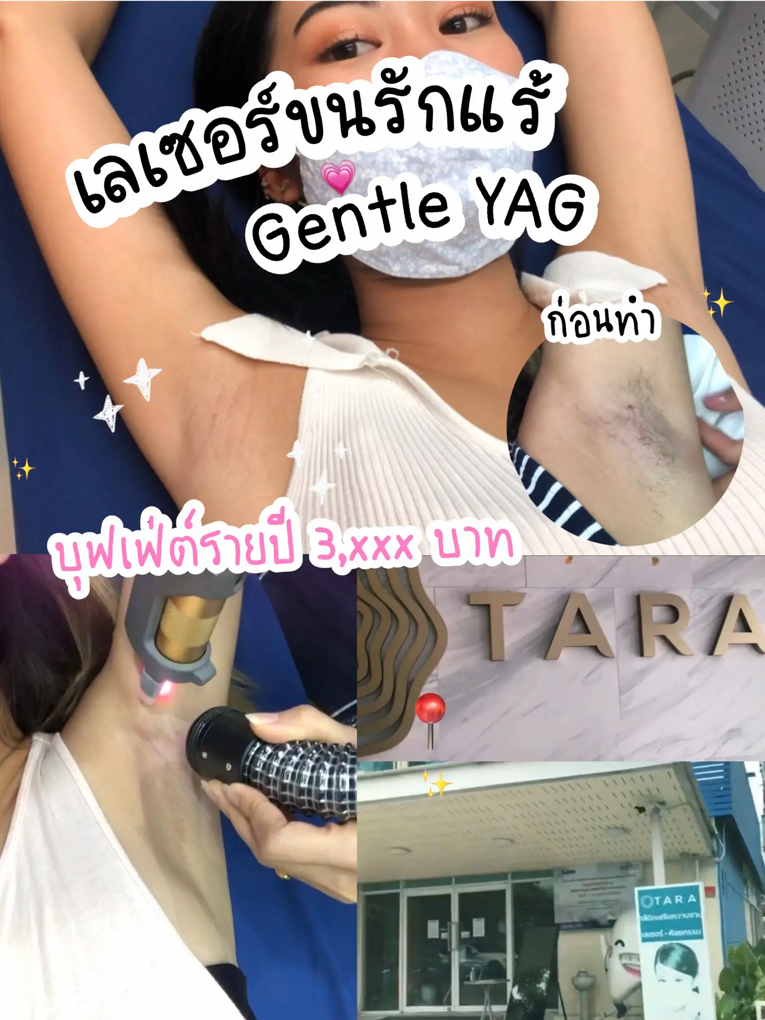 เลเซอร์ขนรักแร้ yag ราคาดี รักแร้เนียนกริบ 3,xxx บาท | แกลเลอรีที่โพสต์โดย Ferngloryy | Lemon8