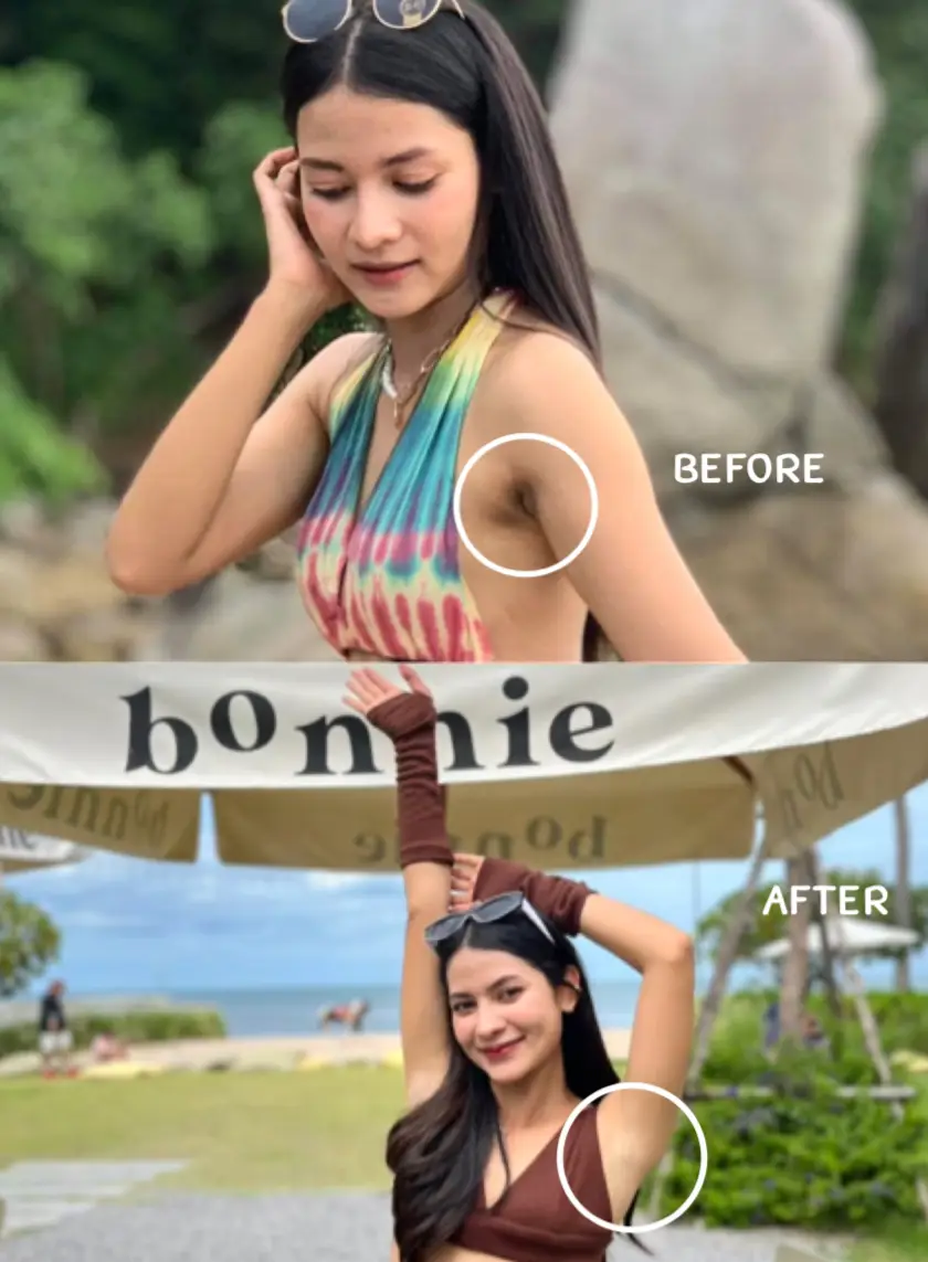 แชร์ประสบการณ์แพ้โรลออน รักแร้ดำมา 17 ปี | แกลเลอรีที่โพสต์โดย Kesinee.K | Lemon8