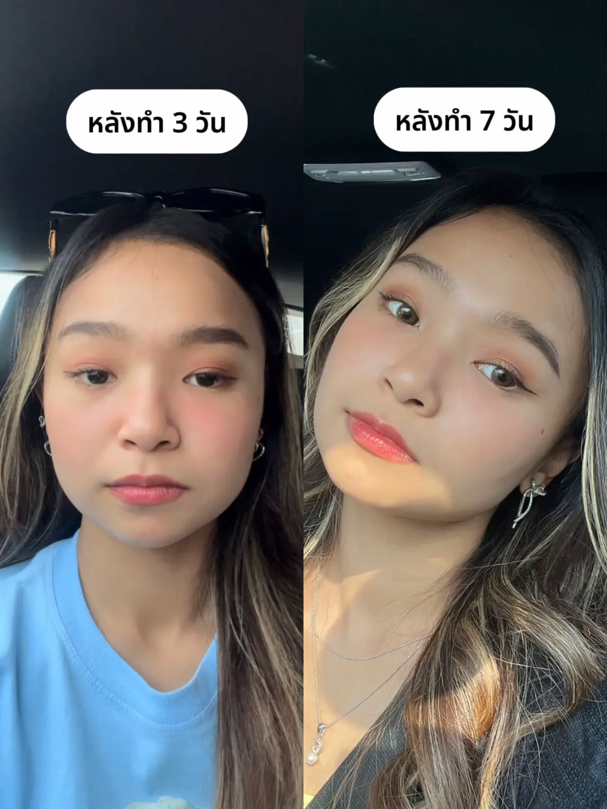 ฉีดแฟต Sisi - การค้นหาใน Lemon8