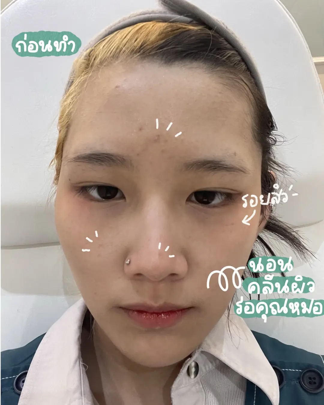 💉 รีวิวเมโสหน้าใส 299B 𓂃 สามวันรอยสิวจาง 🫧 | แกลเลอรีที่โพสต์โดย วิฬาร์ /ᐠ •⩊•マ | Lemon8