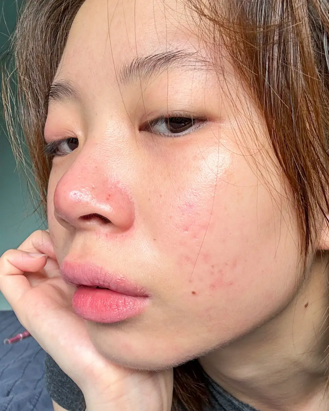 Before you start on Oratane/Accutane... | Gallery posted by faith (๑˃ᴗ ...