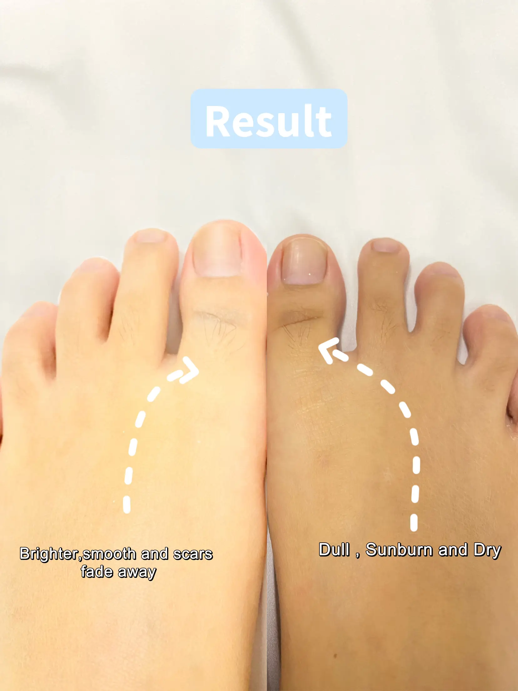 Bye-bye sunburn feet : only 3 Simple Steps 👣 | แกลเลอรีที่โพสต์โดย Love ...