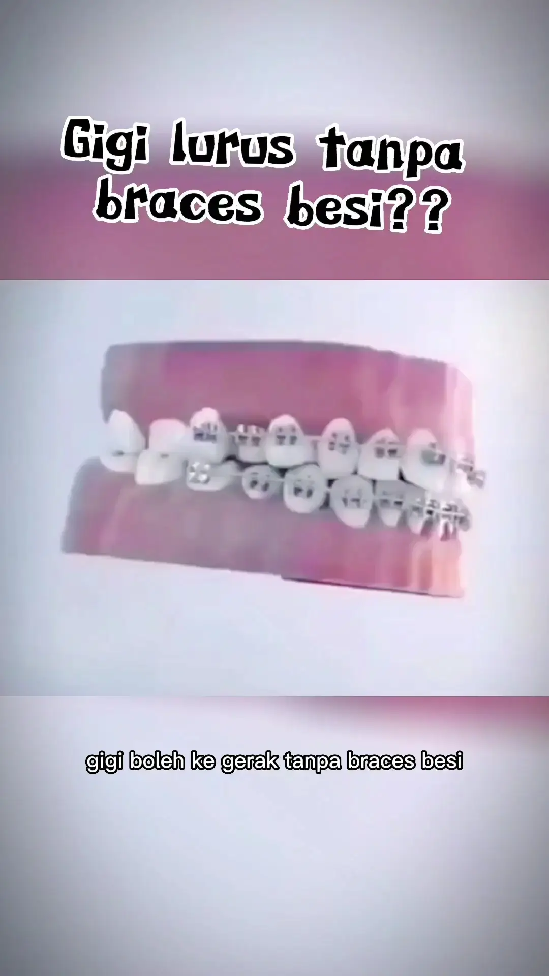 Gigi boleh lurus tanpa braces besi?? | Video published by Dr CK 🦷 🪥 | Lemon8