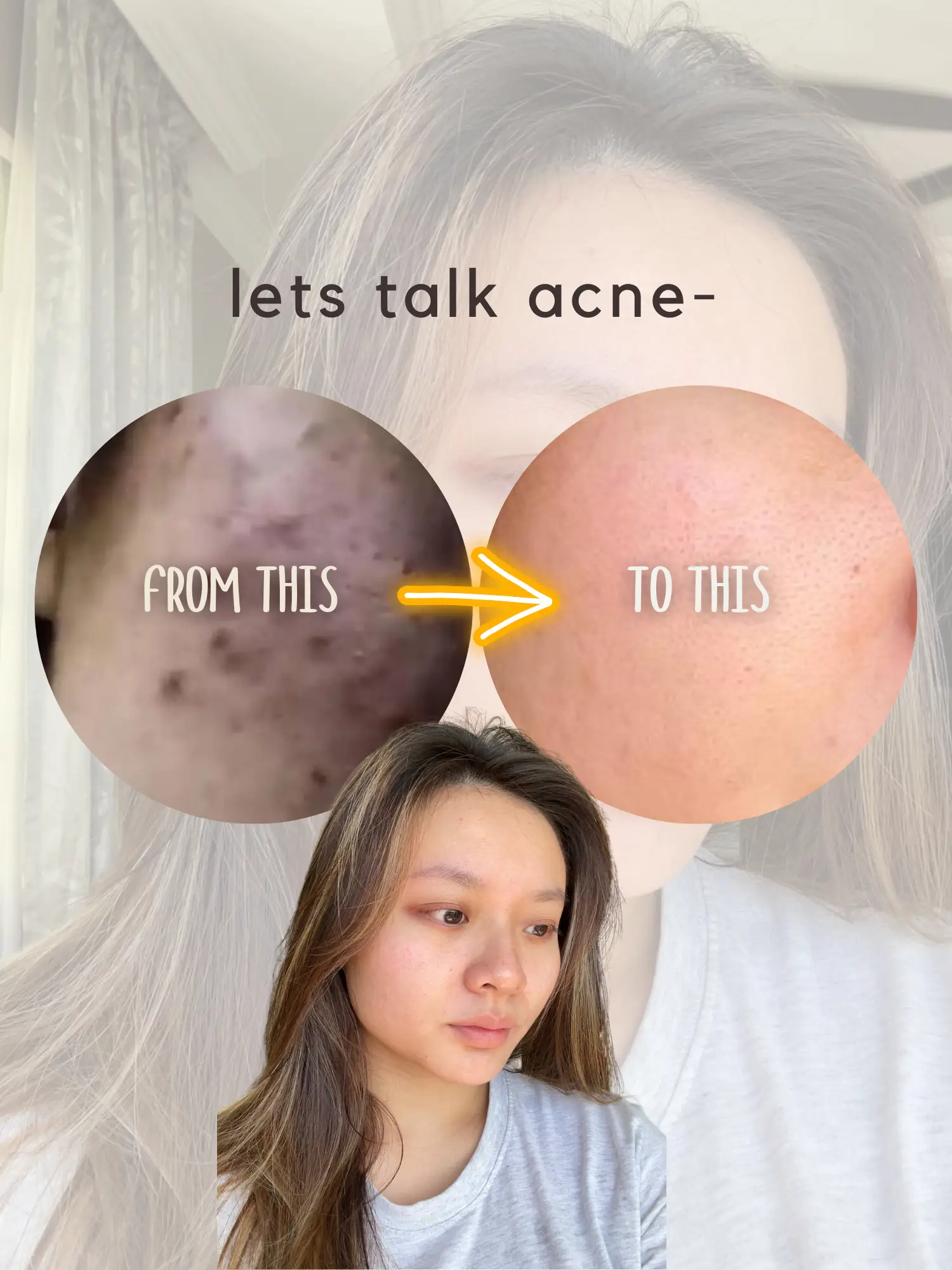 Finally cleared my skin 😮‍💨 My Acutane Experience | แกลเลอรีที่โพสต์โดย ...