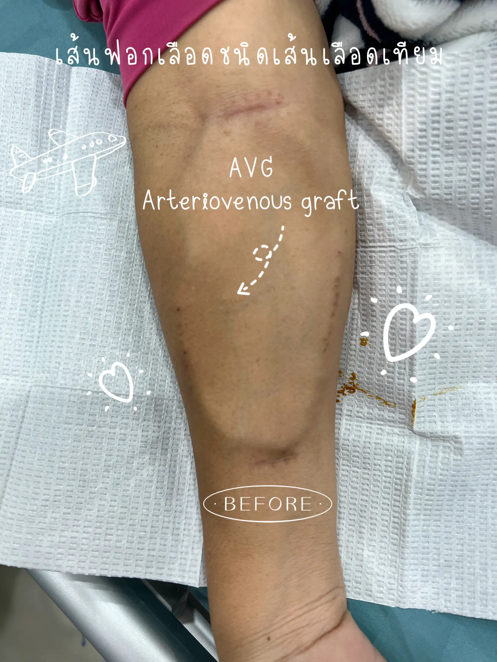 2. AVG Arteriovenous graft | แกลเลอรีที่โพสต์โดย JaruAmp Janterm | Lemon8