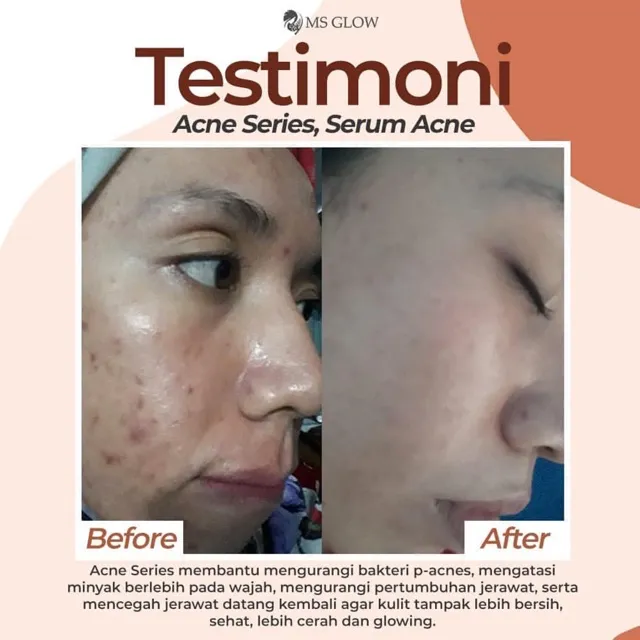 20 ide Perbedaan Golden Glow Dan Biasa Ms Glow teratas di 2024